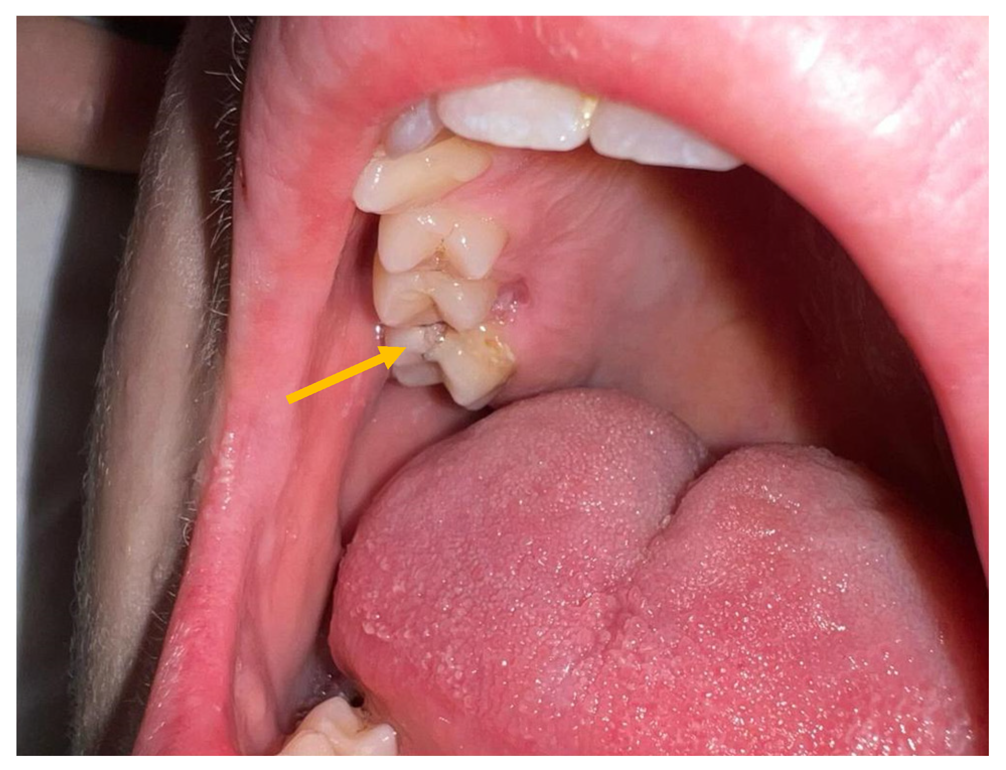 Streptococcus mitis as a New Emerging Pathogen in Pediatric Age: Case ...