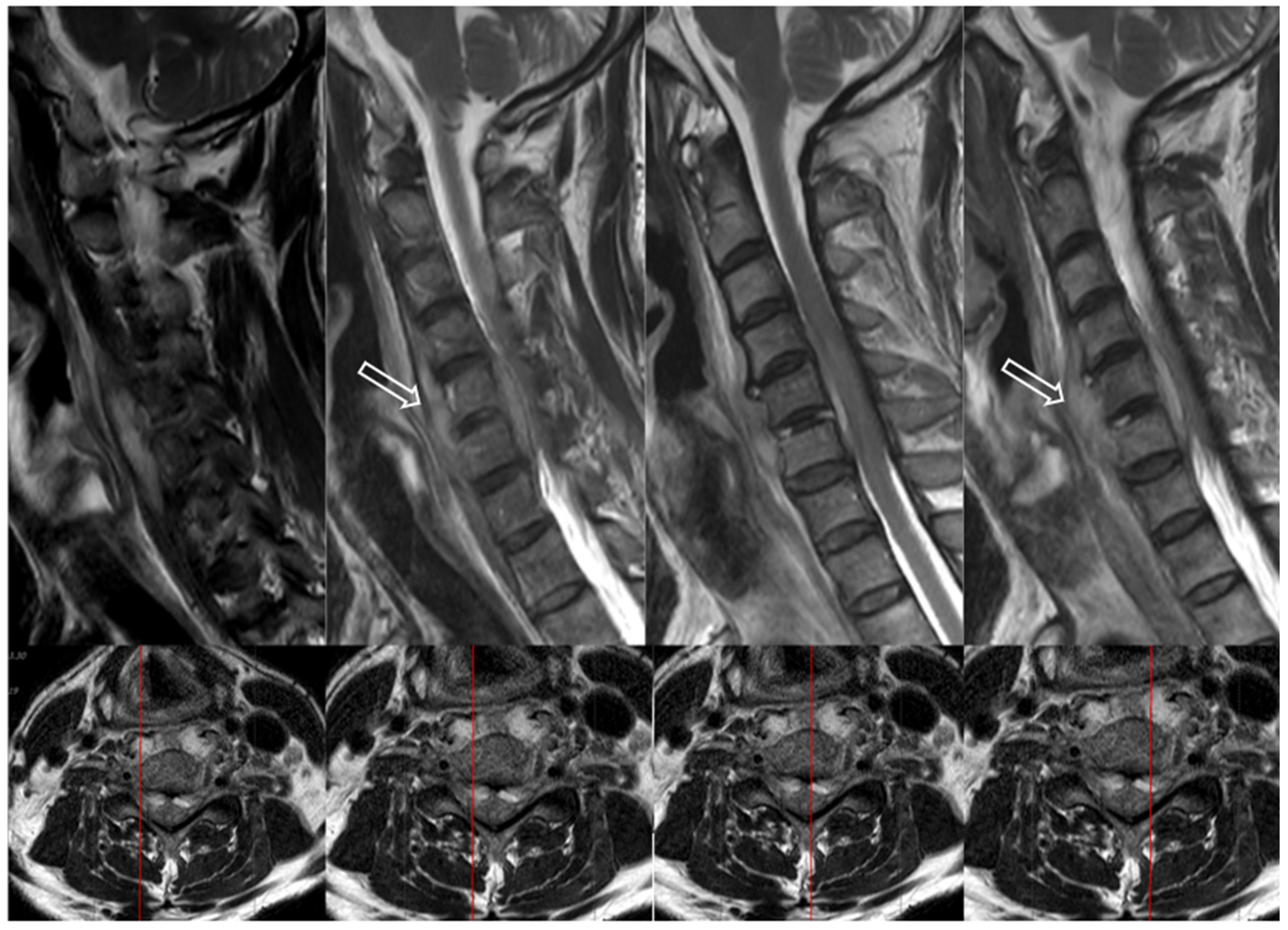 Infective Spondylitis in Adults: A Journey Through Diagnosis ...