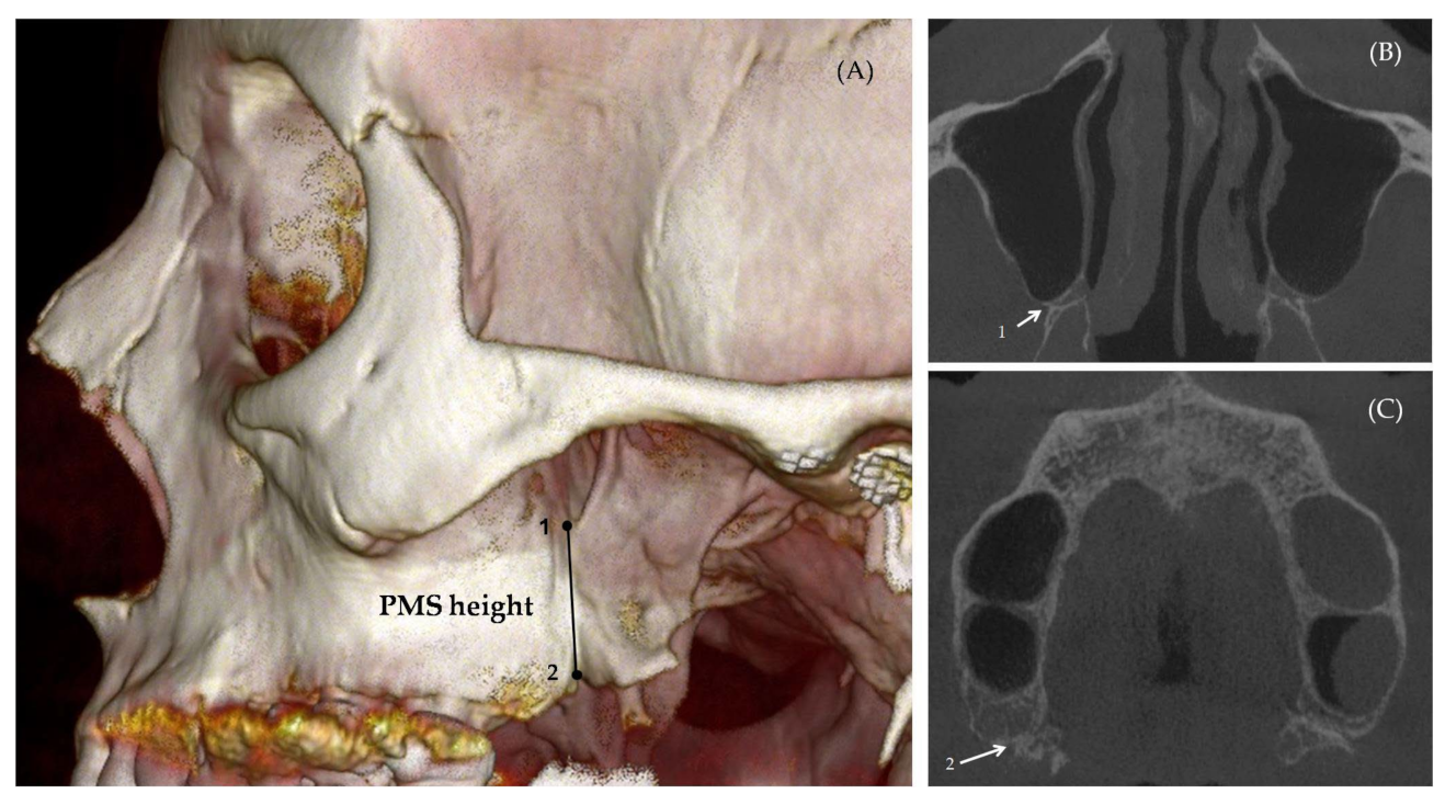 Characterization of Pterygomaxillary Suture Morphology: A CBCT Study | MDPI