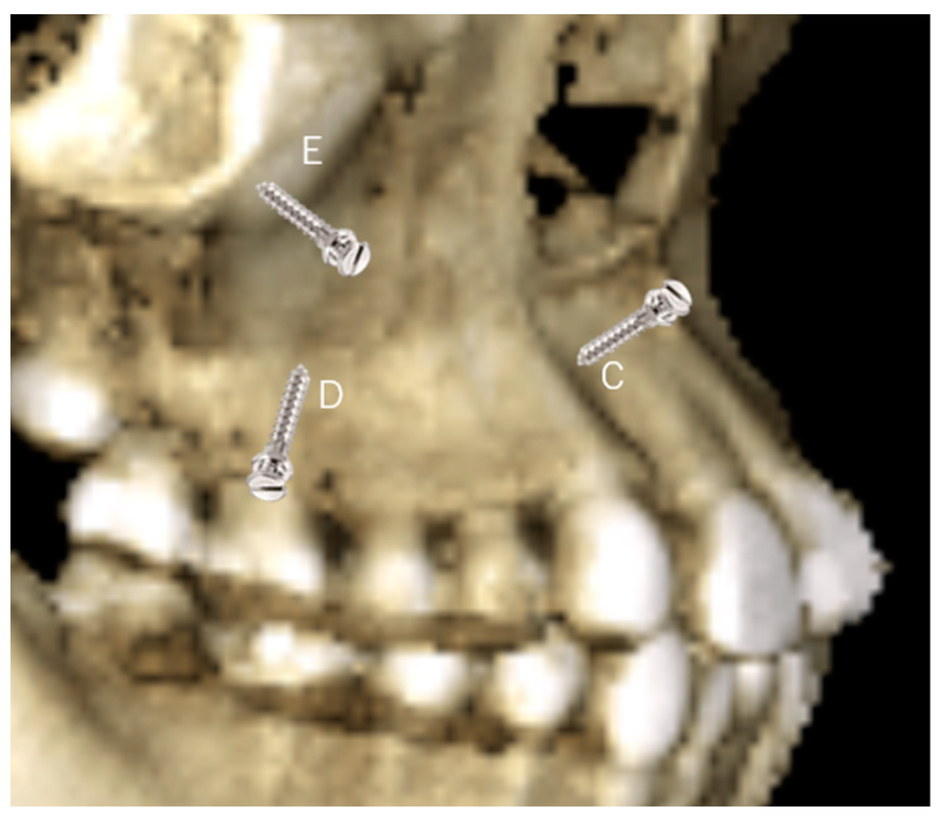 The Surgical Guides for TADs: The Rational and Laboratory Procedures | MDPI