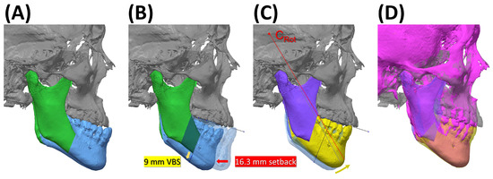 Differential Relapse of Proximal and Distal Segments after Mandibular ...