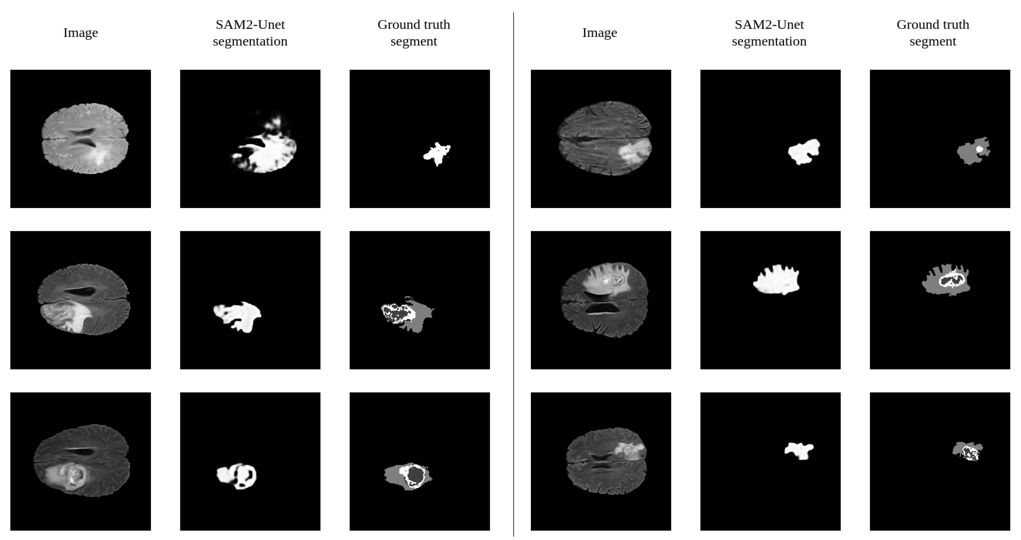 Advanced Brain Tumor Segmentation Using SAM2-UNet | MDPI