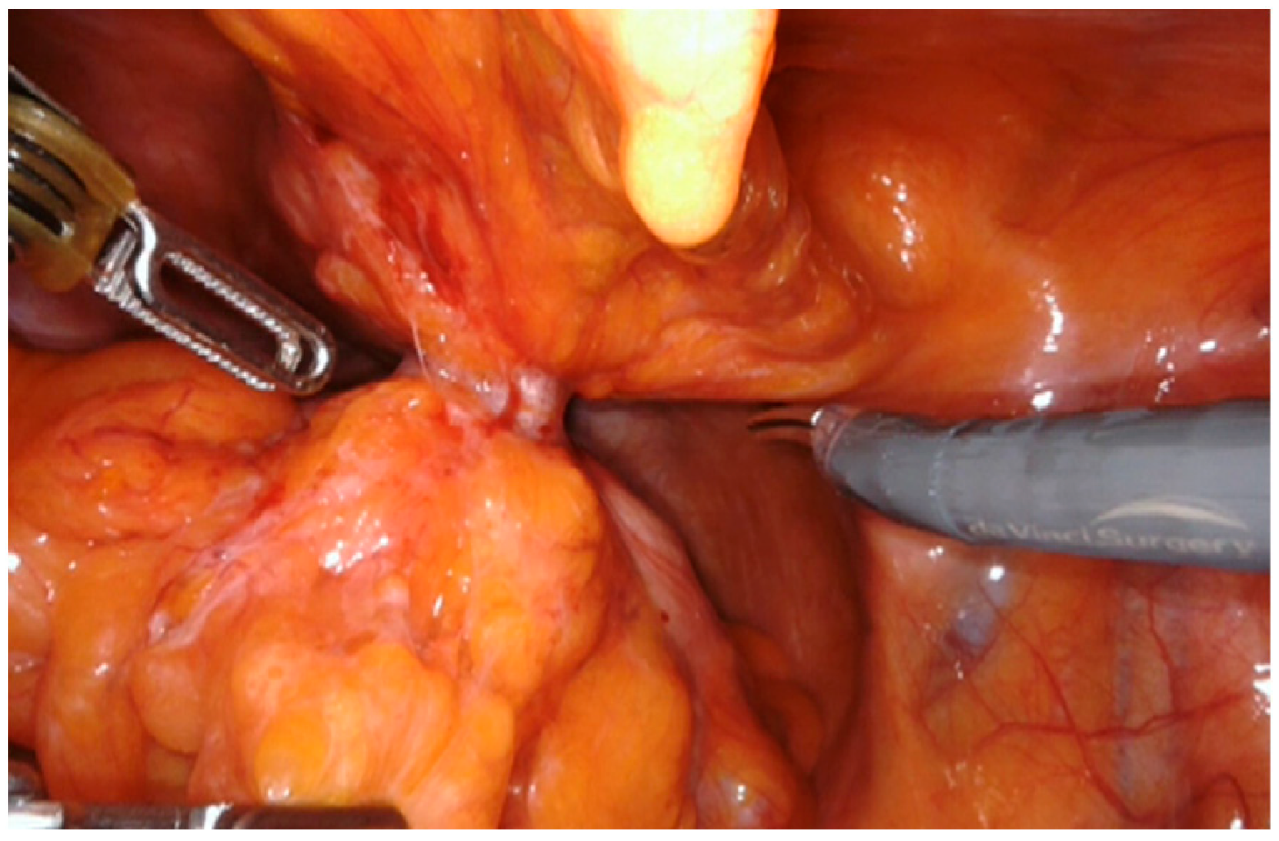 Conservative Surgery for Colovesical Fistula: Evaluating Laparoscopic ...
