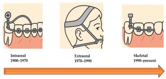 Temporary Anchorage Devices in Orthodontics: A Narrative Review of ...