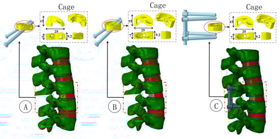 Topological Optimization of Lumbar Intervertebral Fusion Cage with ...