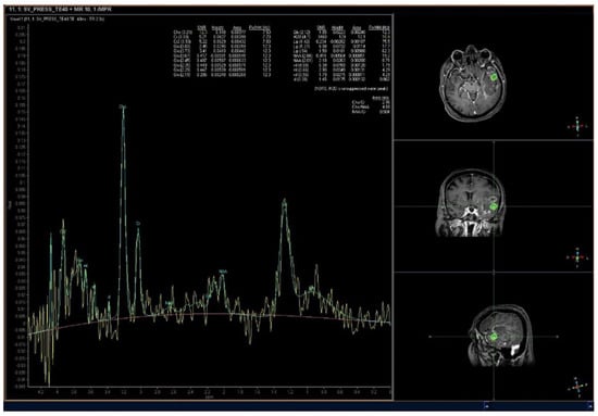 The Role of Advanced MR Imaging in Gliomas | MDPI