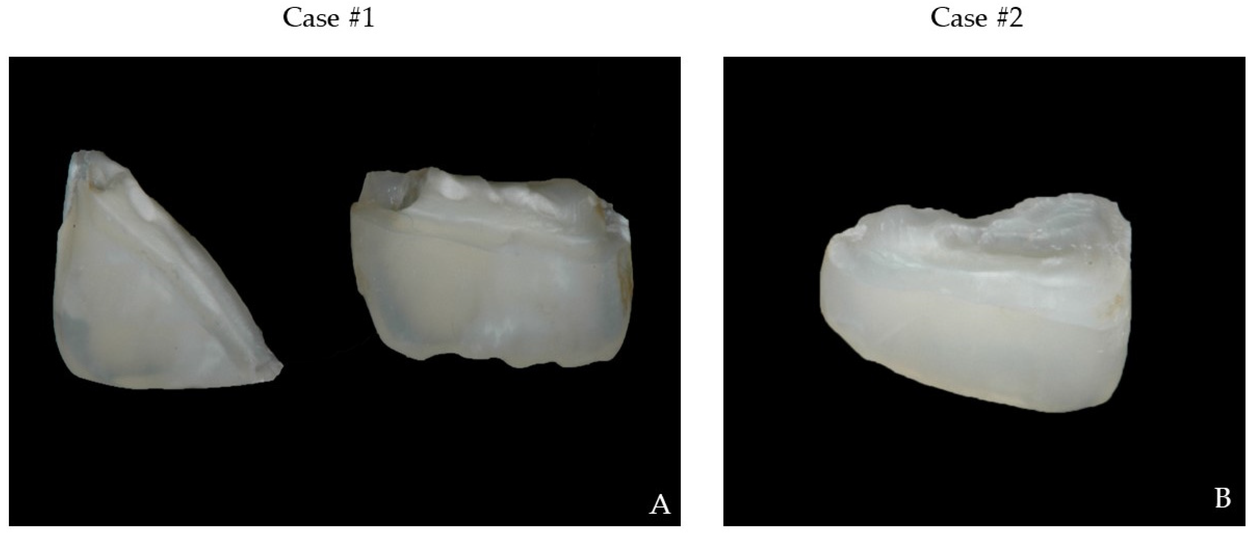 Complicated Crown Fracture of Permanent Incisors: A Conservative ...