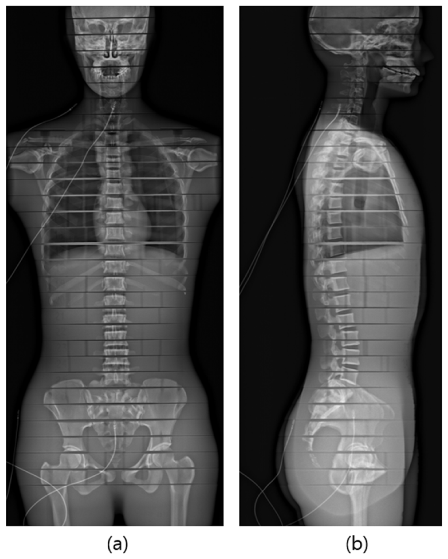 A Whole-Spine Radiography Study to Reduce Patient Exposure Dose and ...