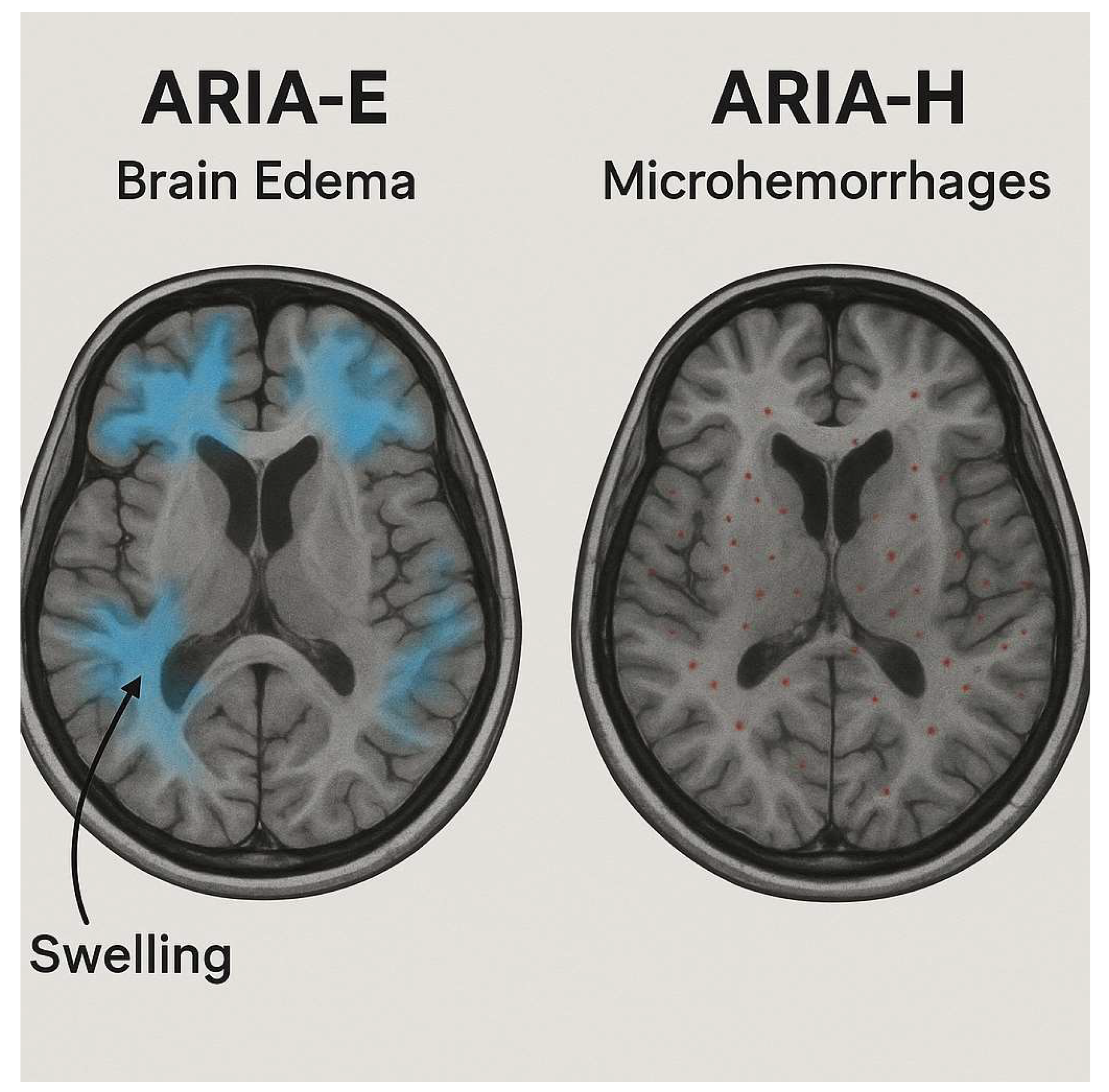 From Lesion to Decision: AI for ARIA Detection and Predictive Imaging ...