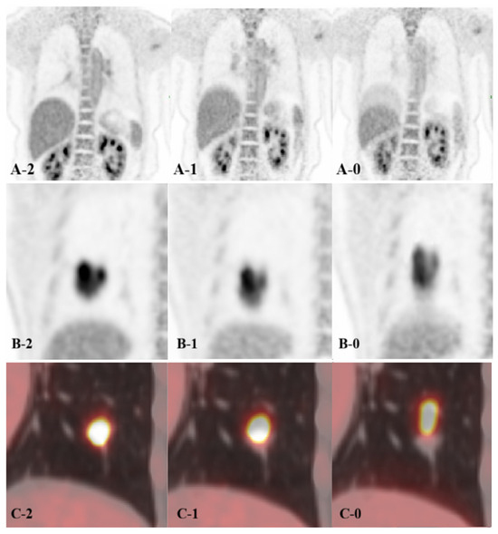Impact of Deep-Learning-Based Respiratory Motion Correction on [18F ...
