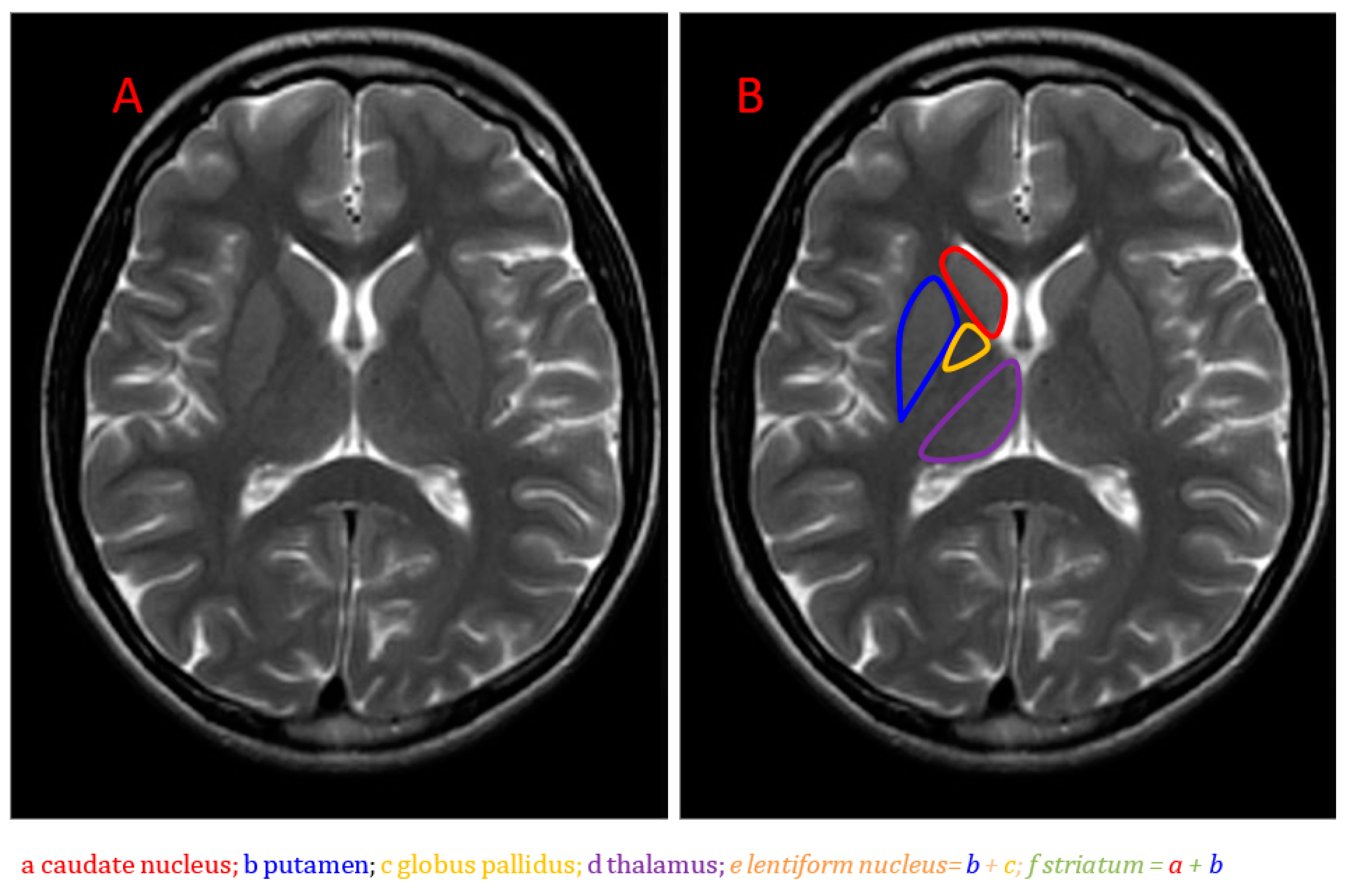 Neuroimaging of Basal Ganglia in Neurometabolic Diseases in Children | MDPI