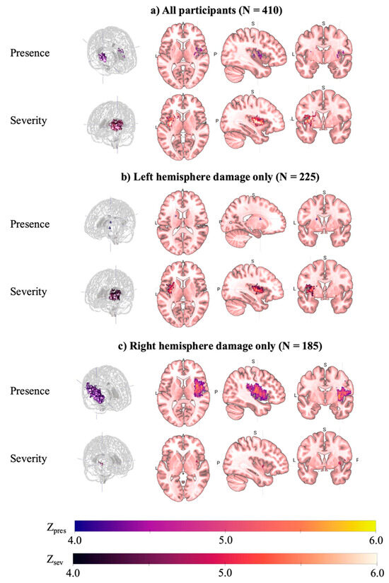 Lesion-Symptom Mapping of Acute Speech Deficits After Left vs. Right ...