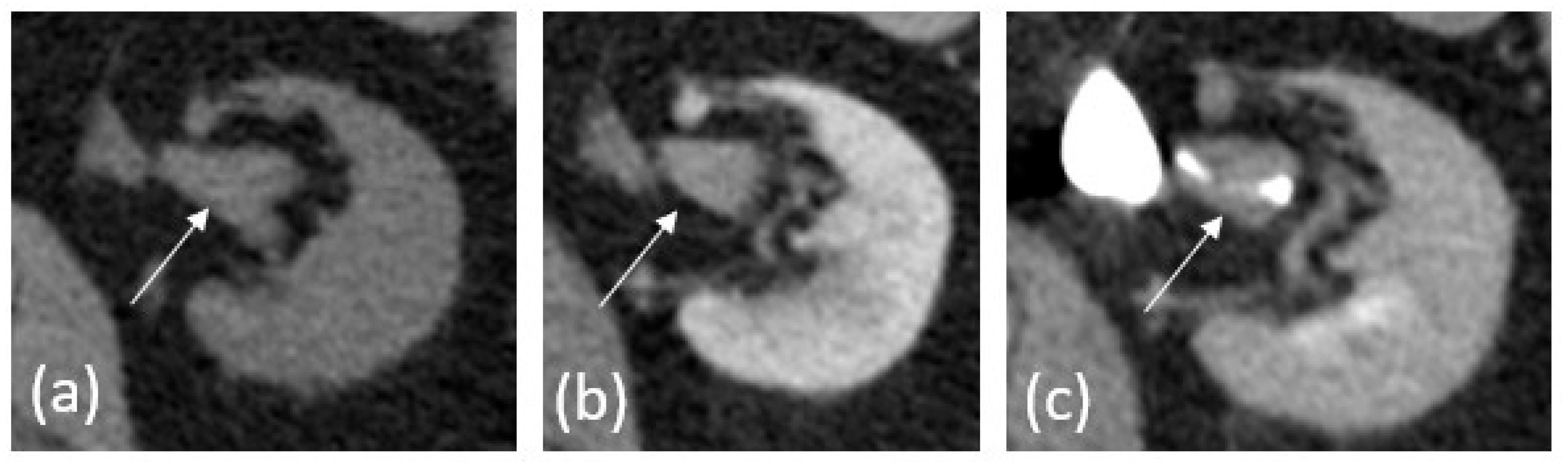 Imaging in Upper Tract Urothelial Carcinoma: A Review | MDPI