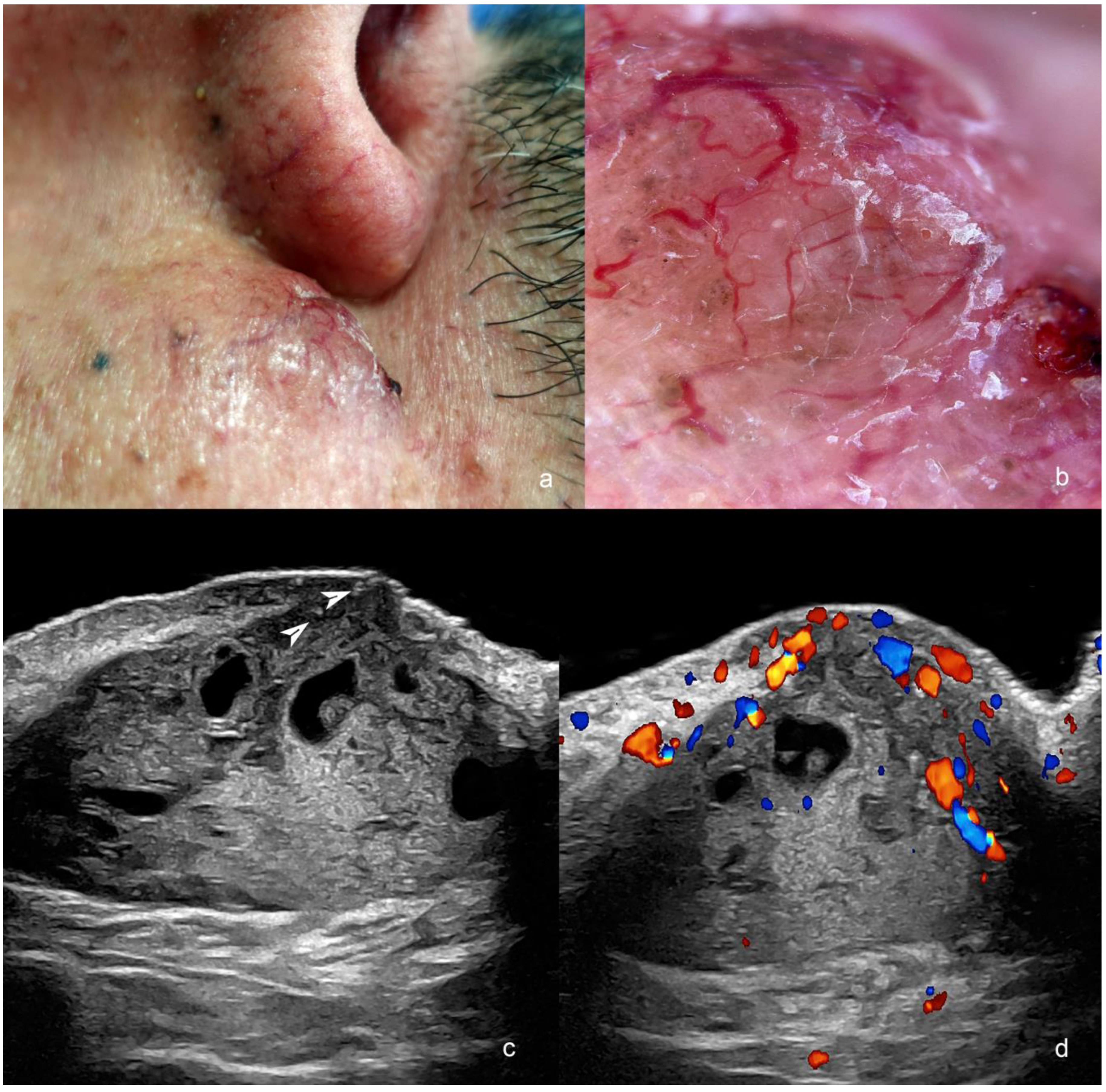 Ultrasound in Skin Cancer: Why, How, and When to Use It? | MDPI