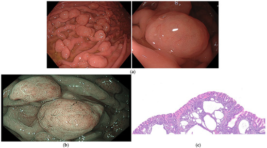 Gastric Epithelial Polyps: Current Diagnosis, Management, and ...