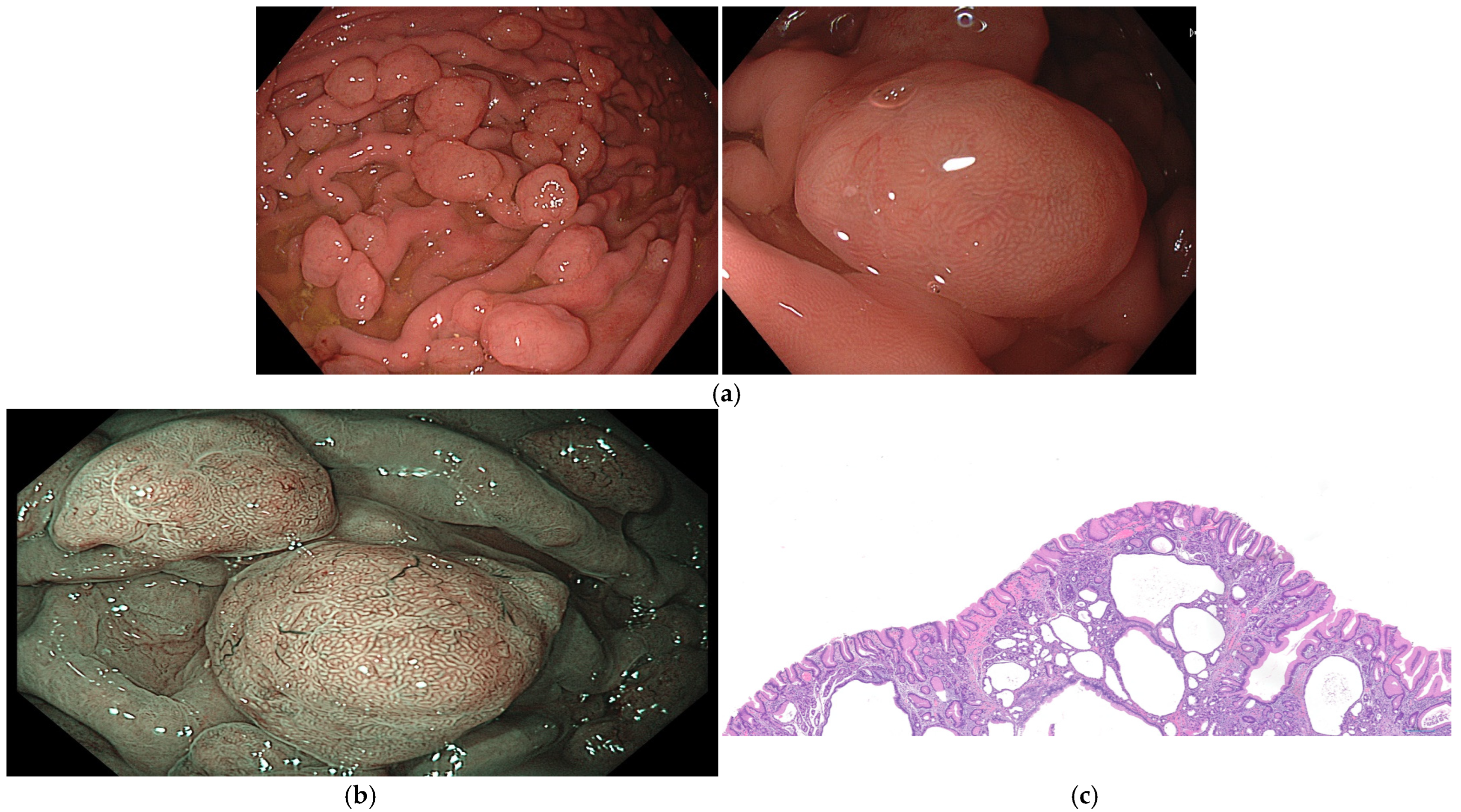 Gastric Epithelial Polyps: Current Diagnosis, Management, and ...