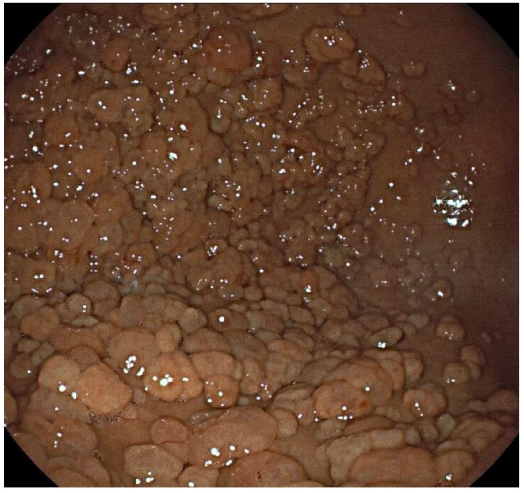 Gastric Epithelial Polyps: Current Diagnosis, Management, and ...