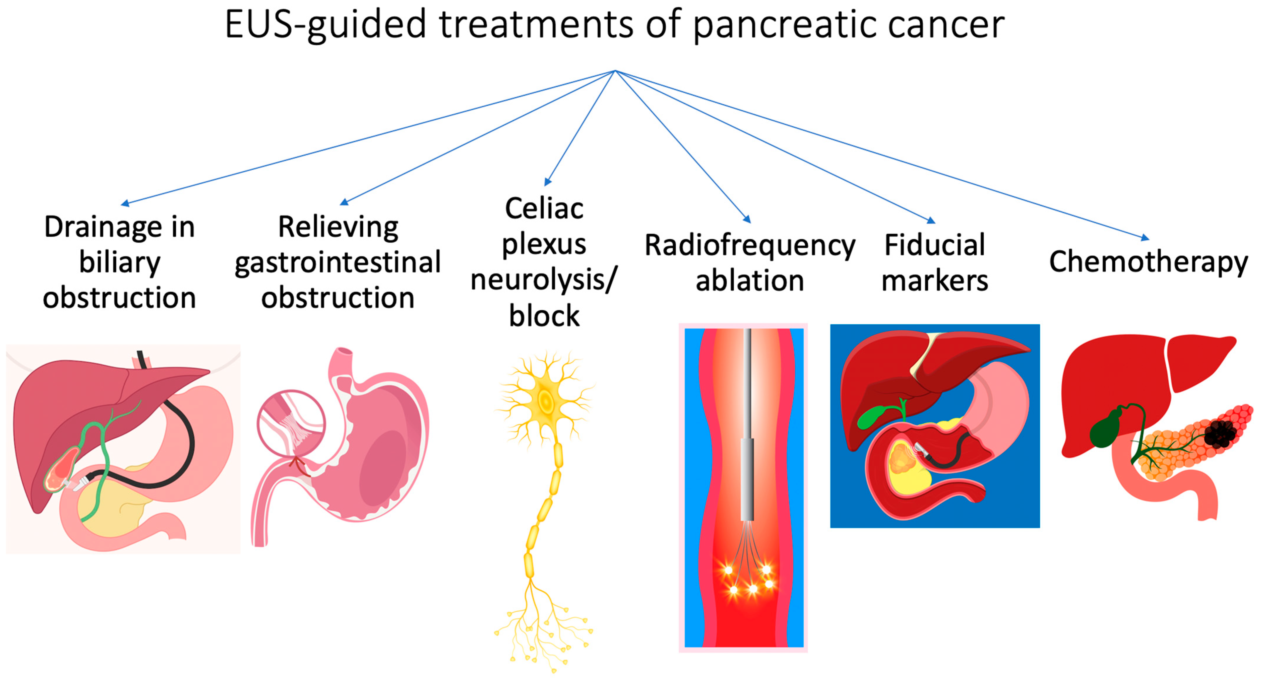 Endoscopic Ultrasound-Guided Treatments for Pancreatic Cancer ...