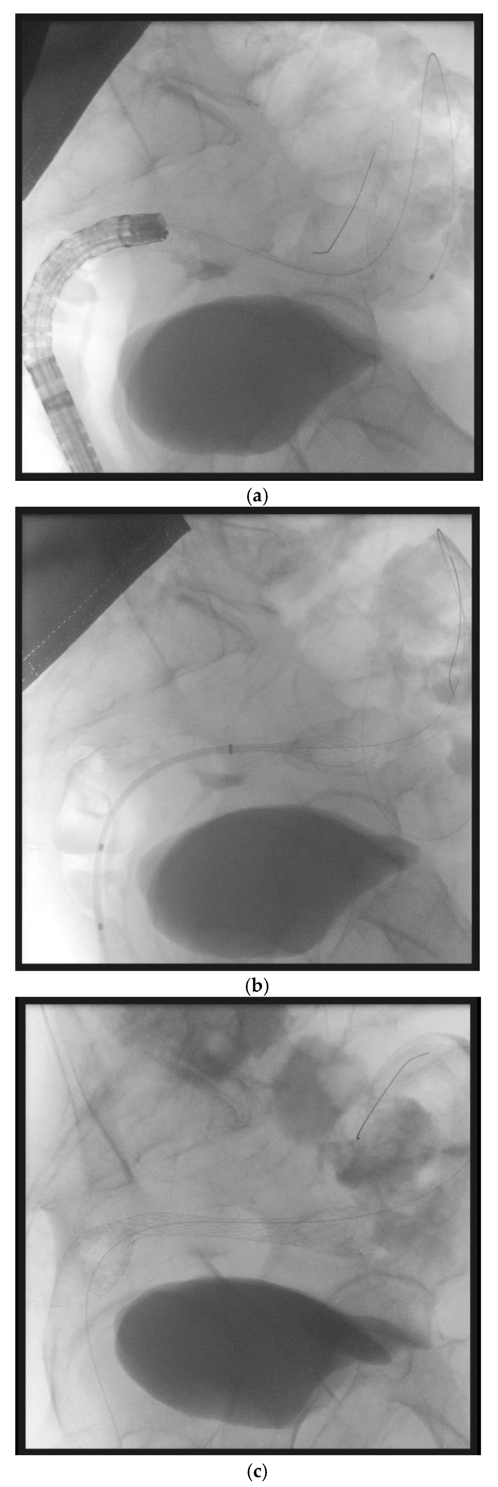 Malignant Bowel Occlusion: An Update on Current Available Treatments | MDPI