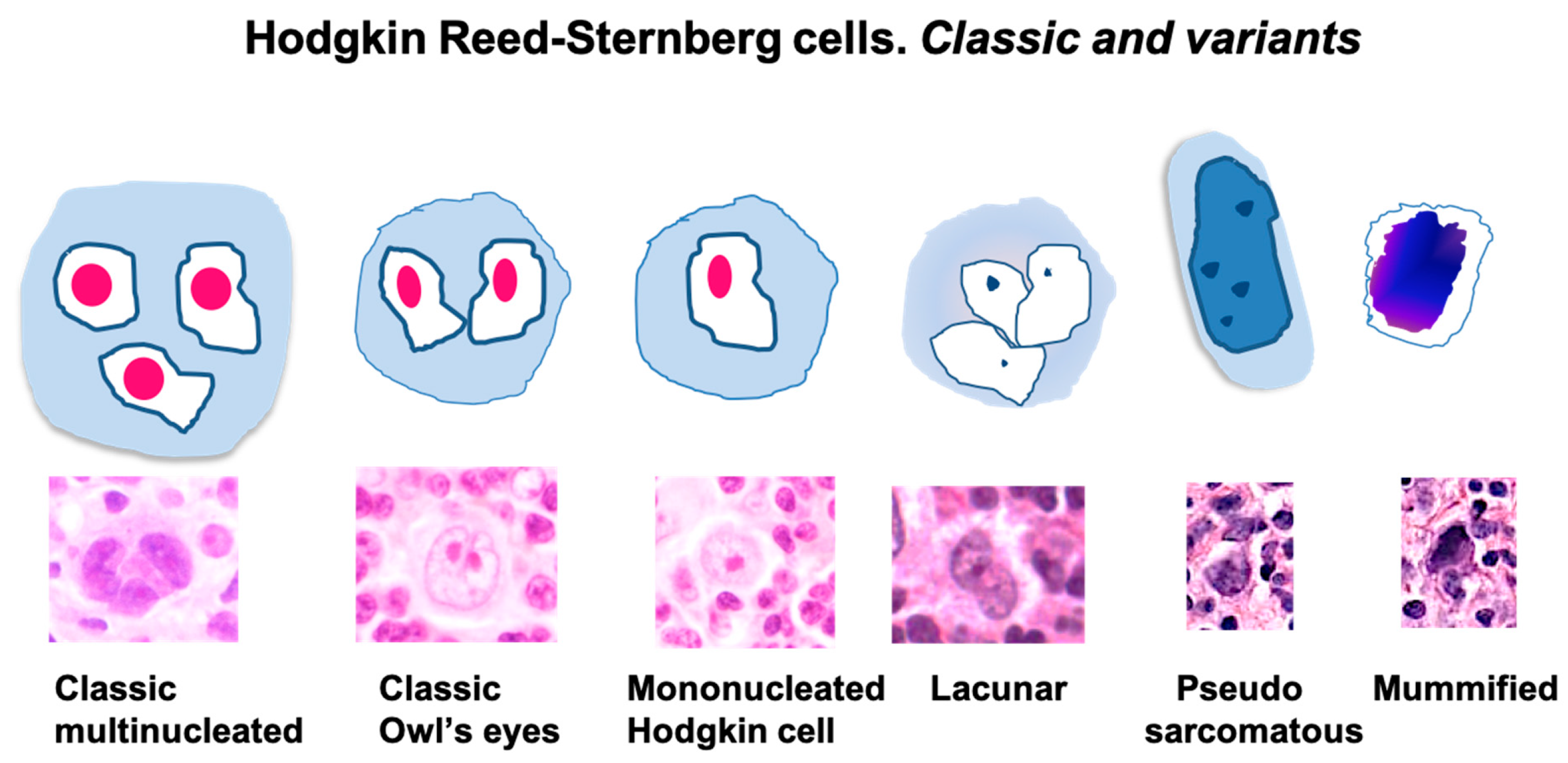 Hodgkin Lymphoma Classification—From Historical Concepts to Current ...
