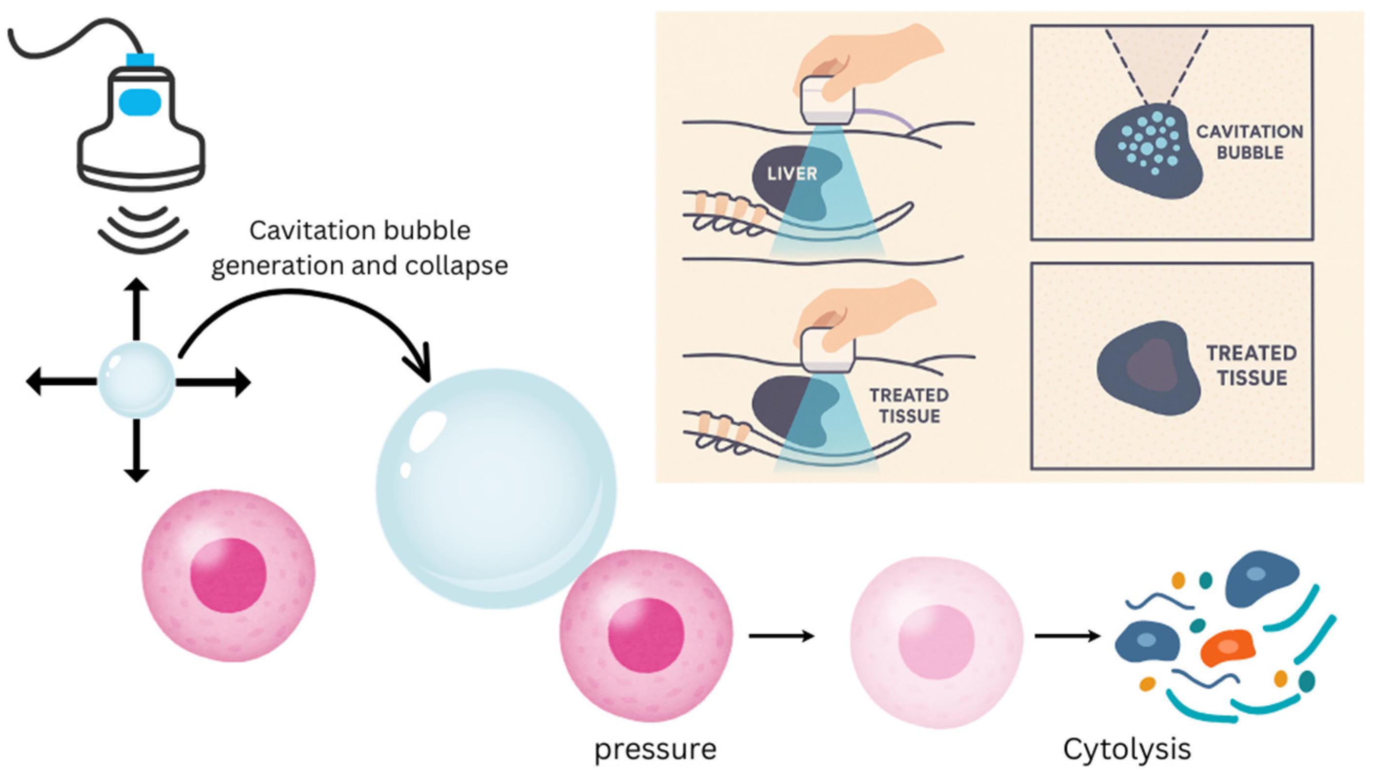 Histotripsy: Recent Advances, Clinical Applications, and Future ...