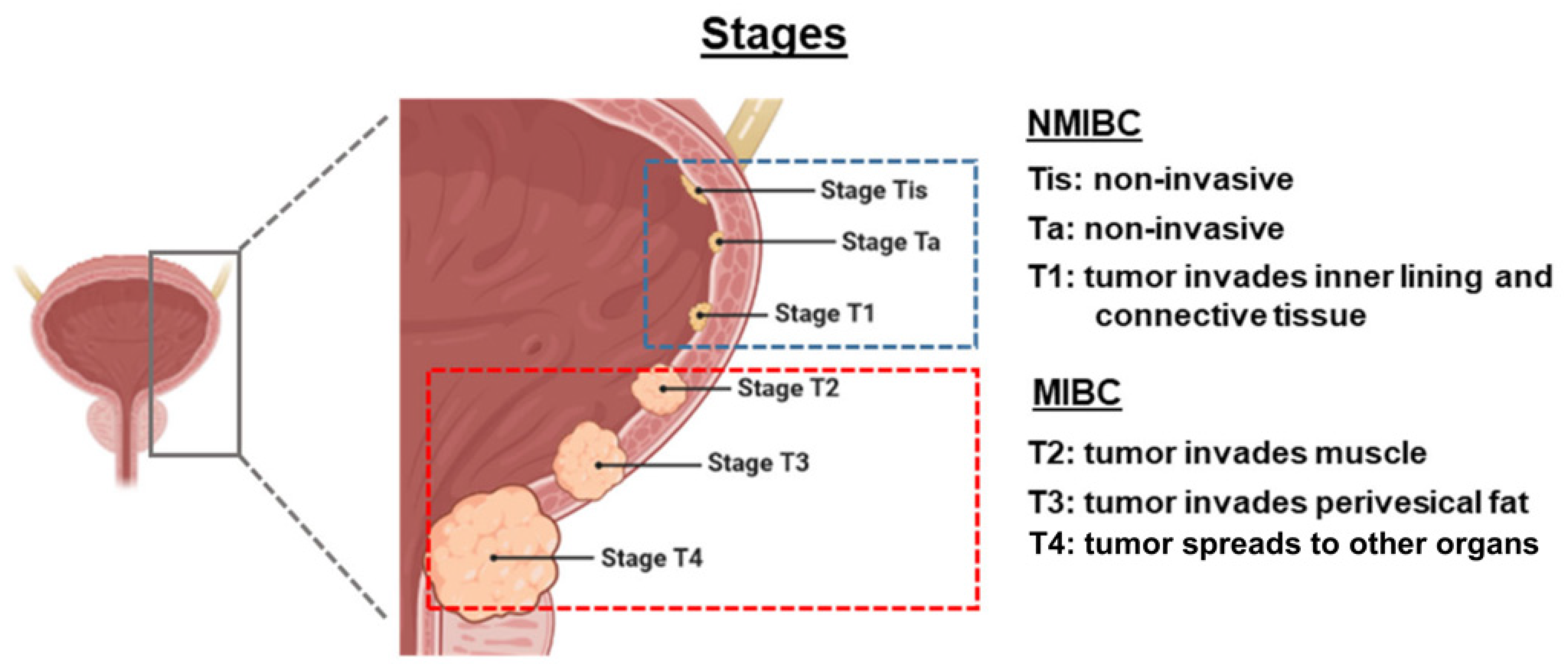 Gene Therapy for BCG-Unresponsive Non-Muscle Invasive Bladder Cancer ...