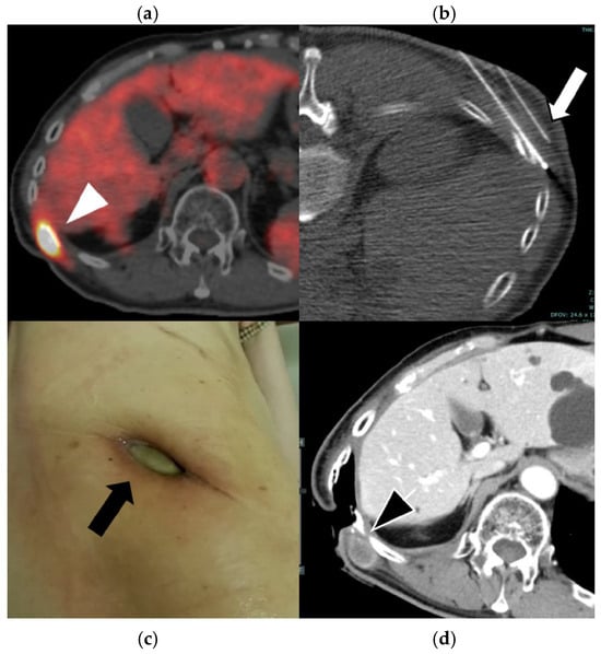 Radiofrequency Ablation for Recurrent Pleural Mesothelioma | MDPI