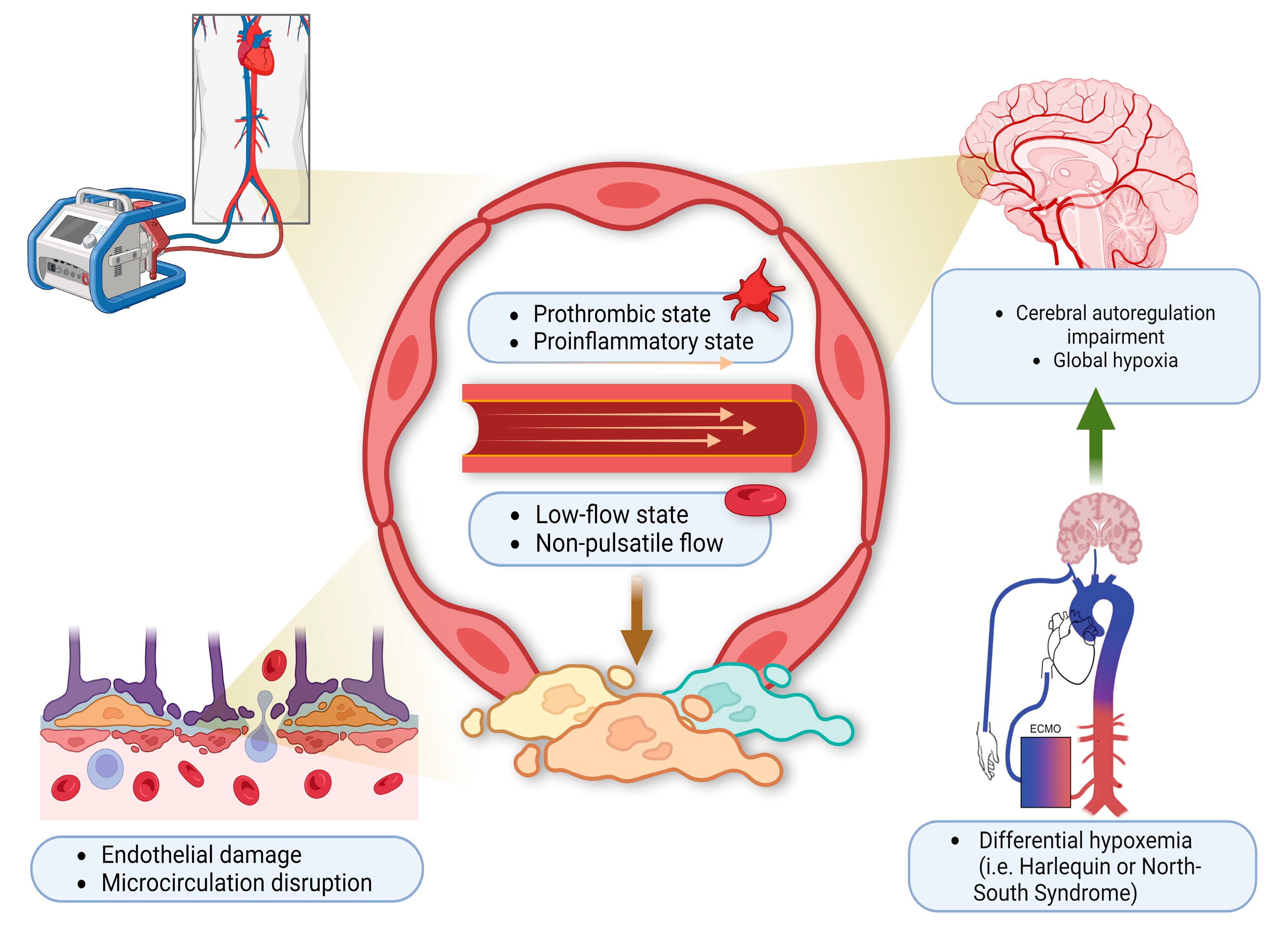 Hypoxic-Ischemic Brain Injury in ECMO: Pathophysiology, Neuromonitoring ...