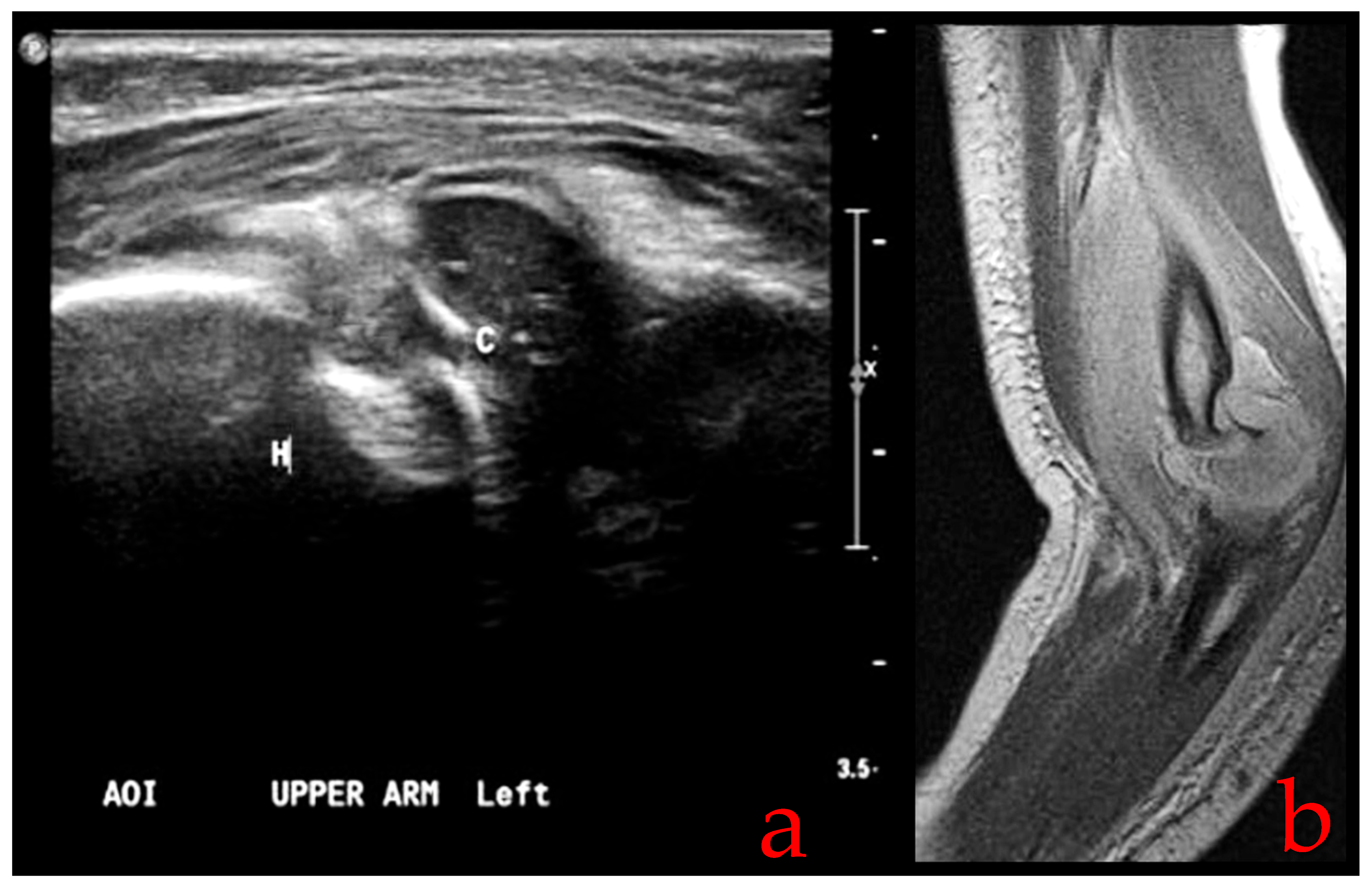 Transphyseal Humeral Separations: An Often-Missed Fracture | MDPI