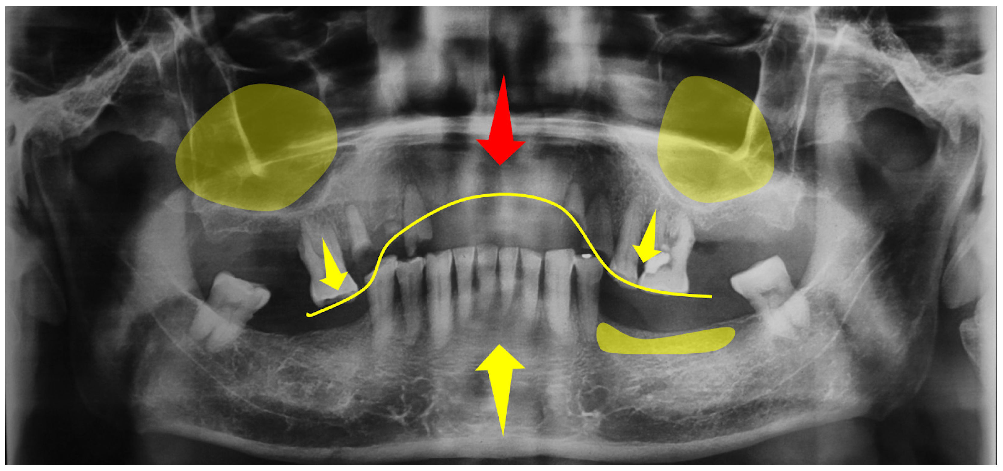 Anterior Hyperfunction Syndrome: Literature Review and Conceptual Model ...