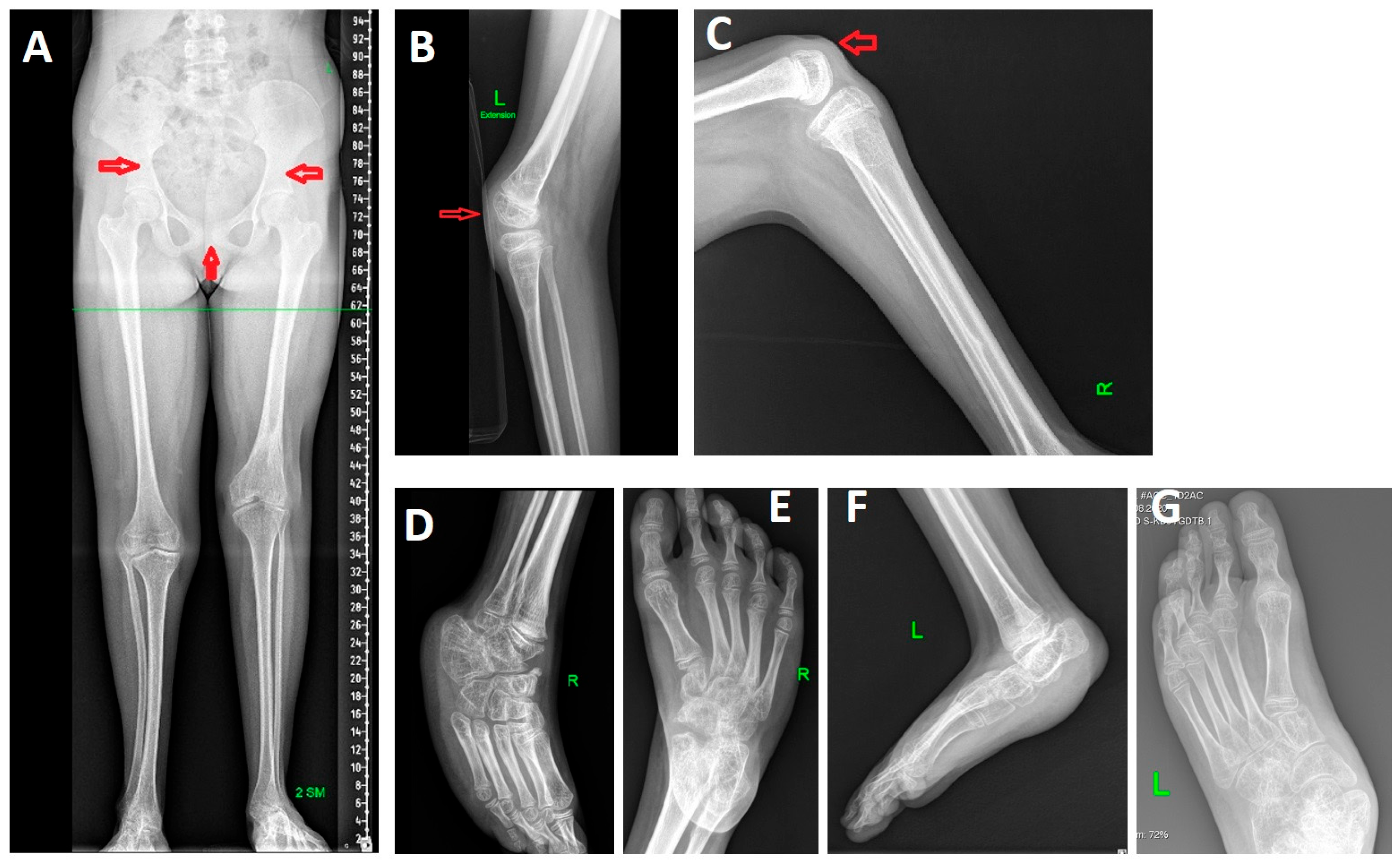 A New Case of PITX1-Related Mandibular–Pelvic–Patellar (MPP) Syndrome ...