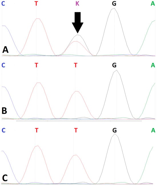 A New Case of PITX1-Related Mandibular–Pelvic–Patellar (MPP) Syndrome ...