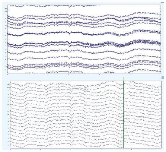 A Complementary Dataset of Scalp EEG Recordings Featuring Participants ...