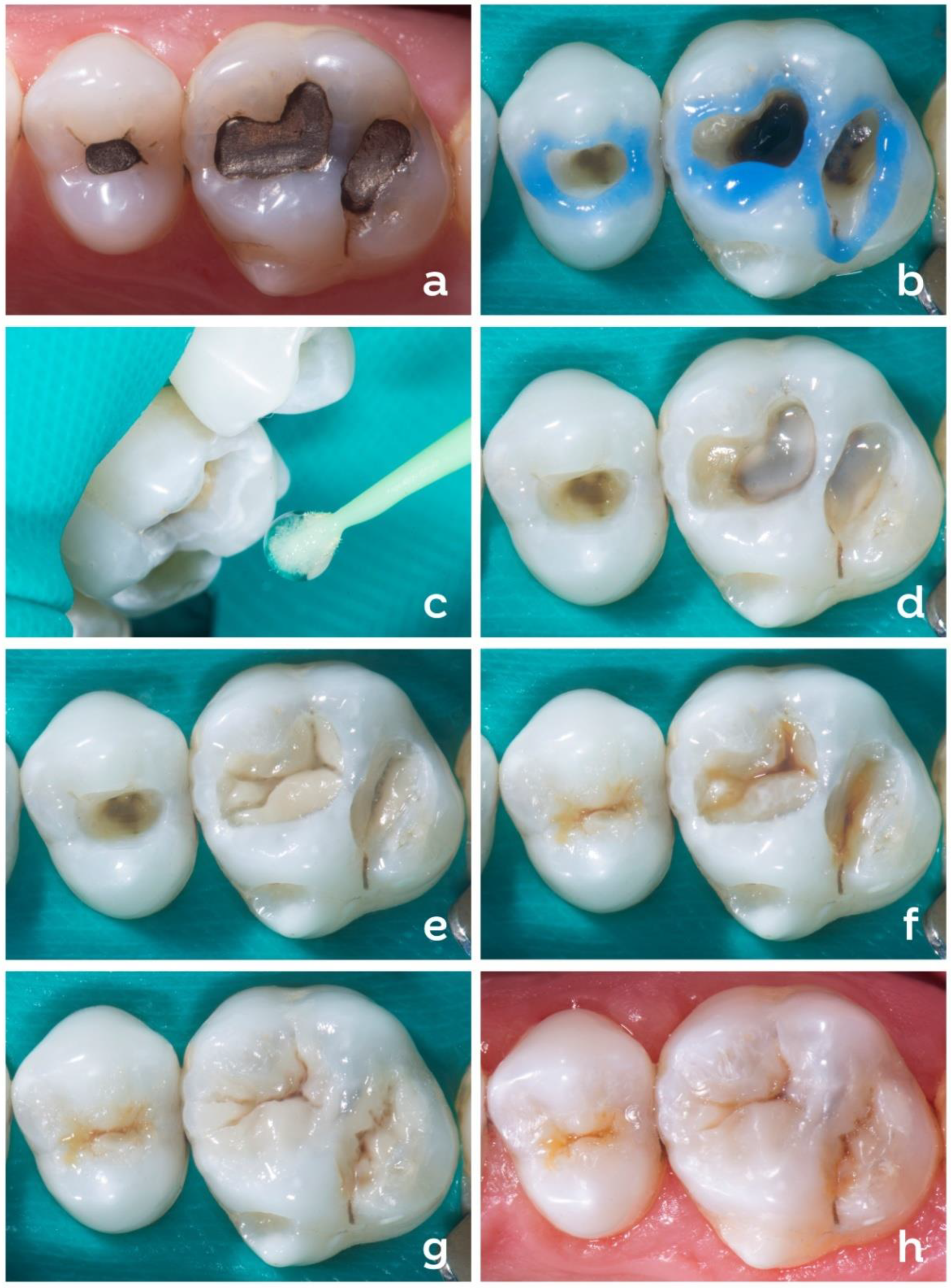 Resin Composites in Posterior Teeth: Clinical Performance and Direct ...
