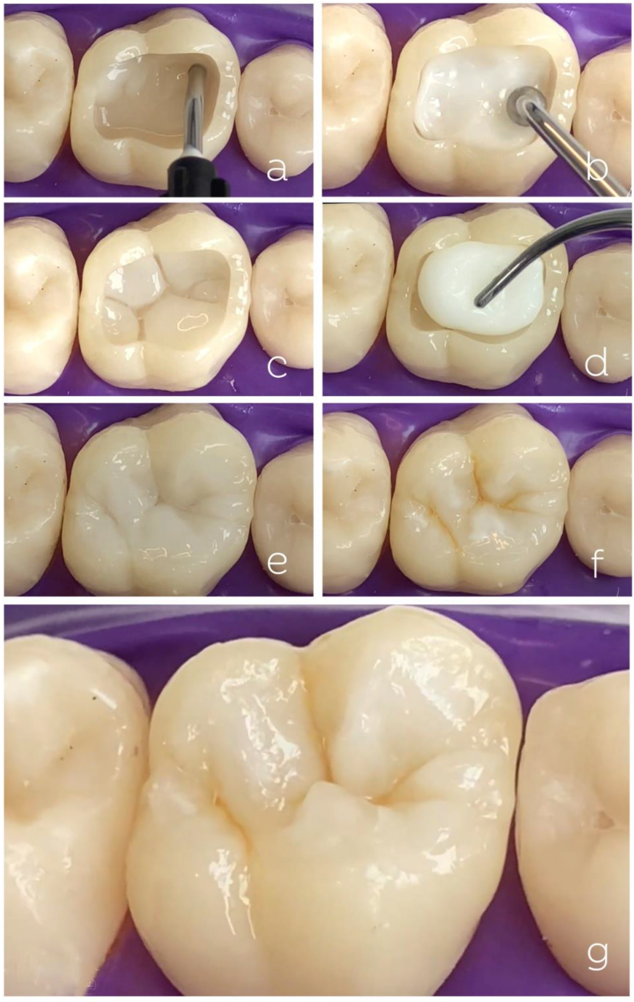 Resin Composites in Posterior Teeth: Clinical Performance and Direct ...
