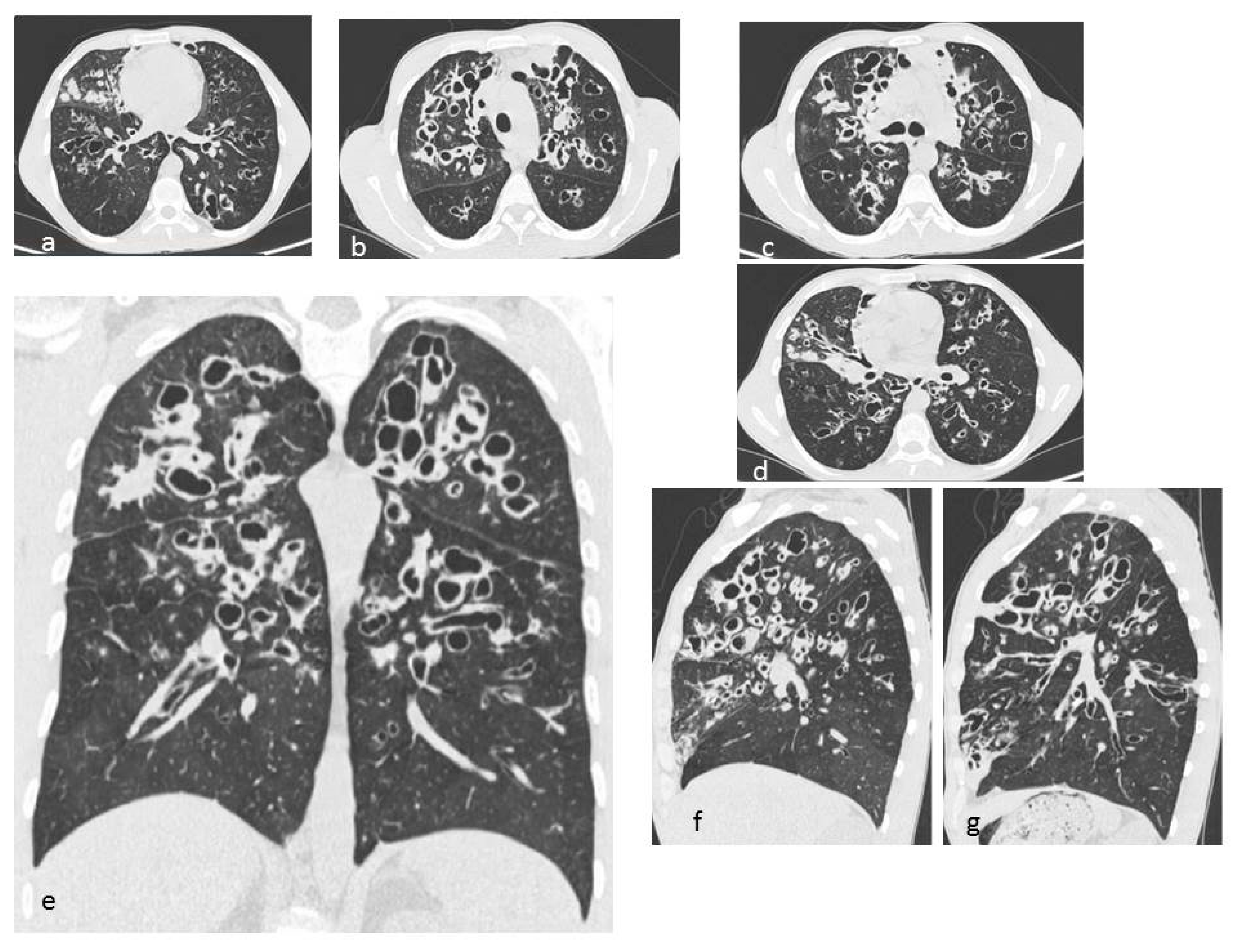 Cystic Interstitial Lung Diseases: A Pictorial Review and a Practical ...