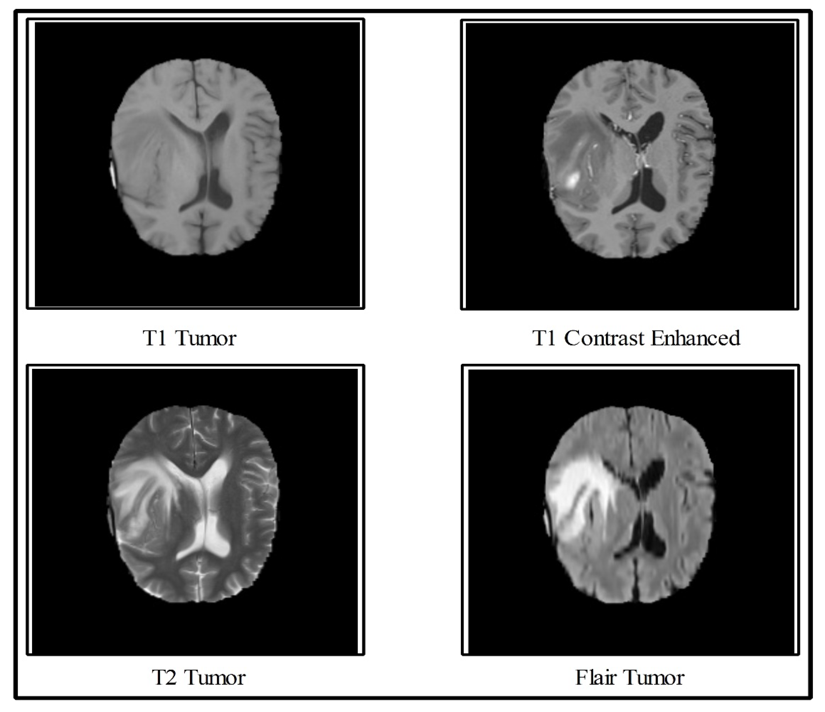 Multimodal Brain Tumor Classification Using Deep Learning and Robust Feature Selection: A ...