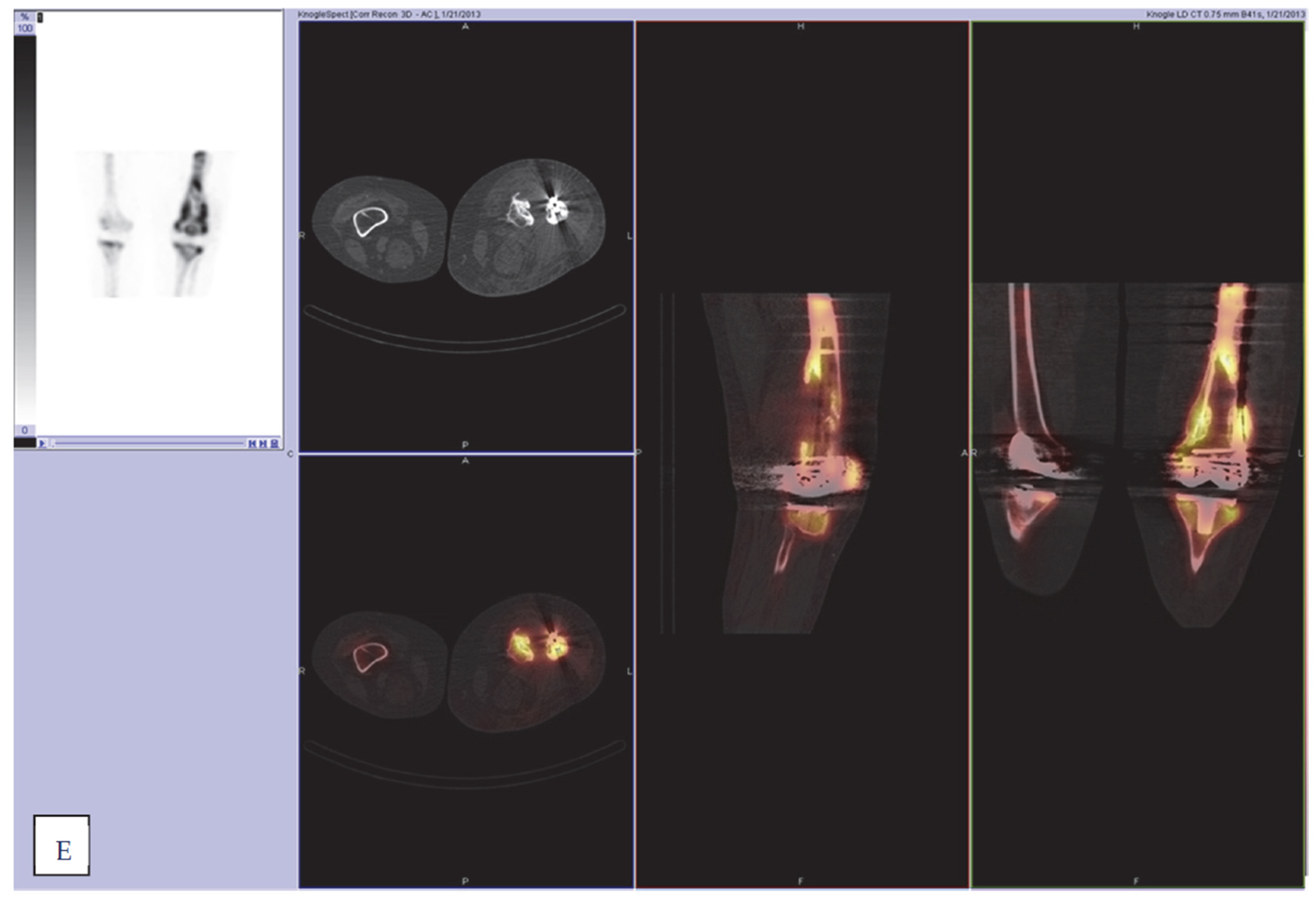The Role of Nuclear Medicine Imaging with 18F-FDG PET/CT, Combined ...