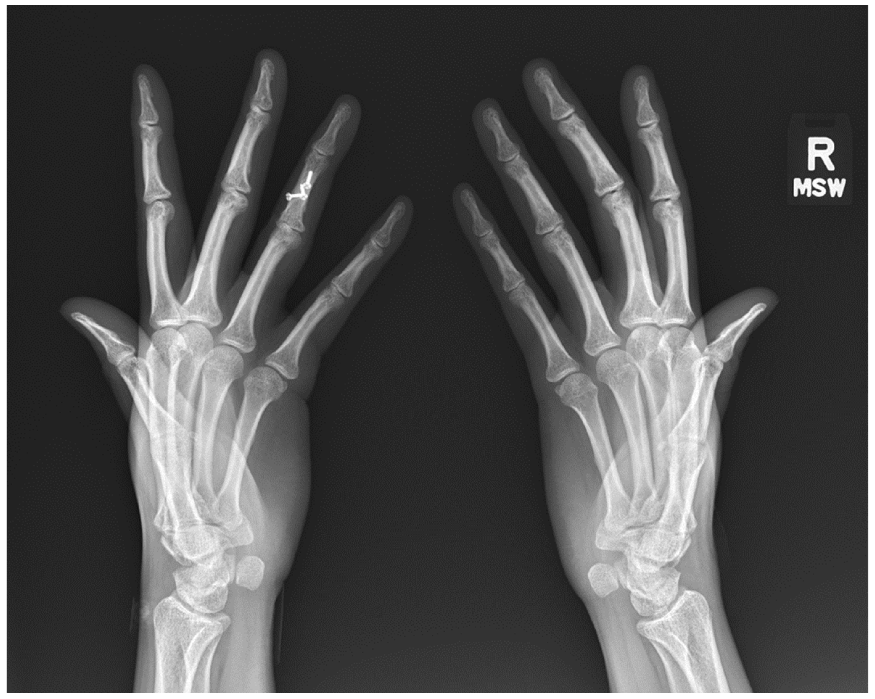 Radiographic Findings of Inflammatory Arthritis and Mimics in the Hands ...