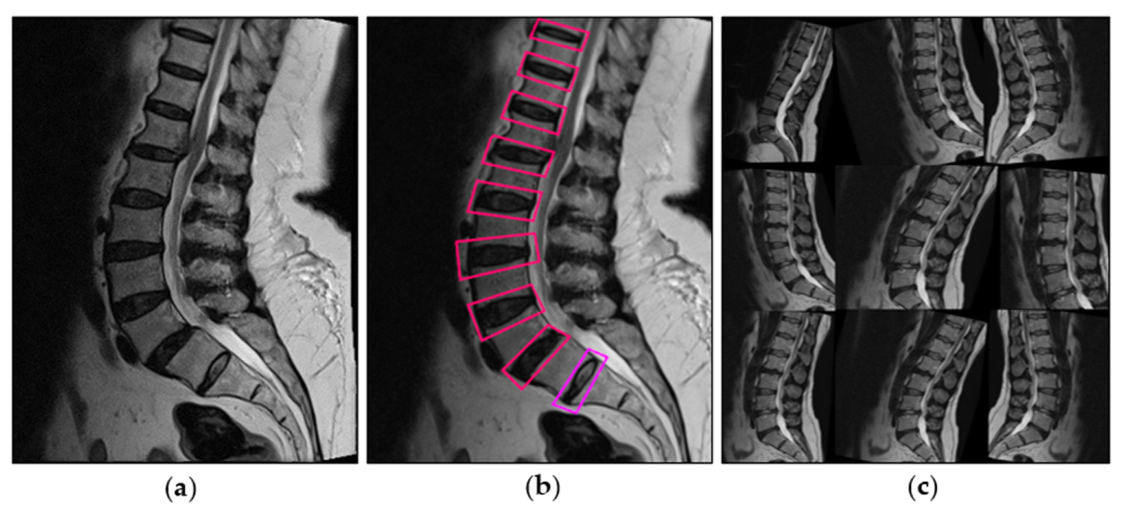 Automatic Detection, Classification, and Grading of Lumbar ...