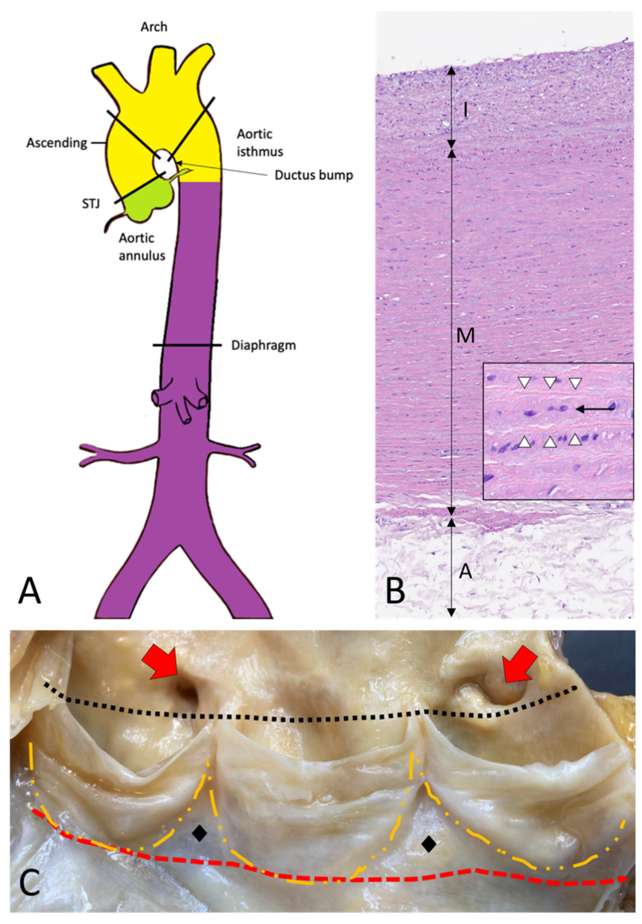 Thoracic Aorta: Anatomy and Pathology | MDPI