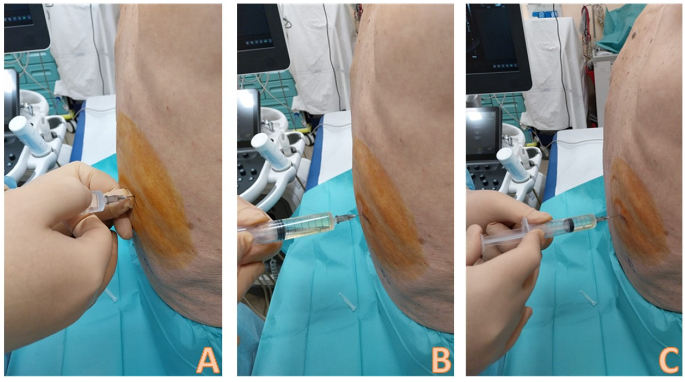 Ultrasound-Assisted and Ultrasound-Guided Thoracentesis: An Educational ...