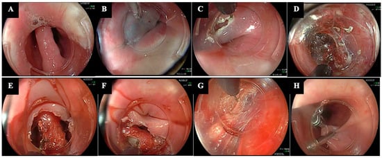 The Endoscopic Management of Zenker’s Diverticulum: A Comprehensive ...