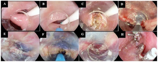 The Endoscopic Management of Zenker’s Diverticulum: A Comprehensive ...