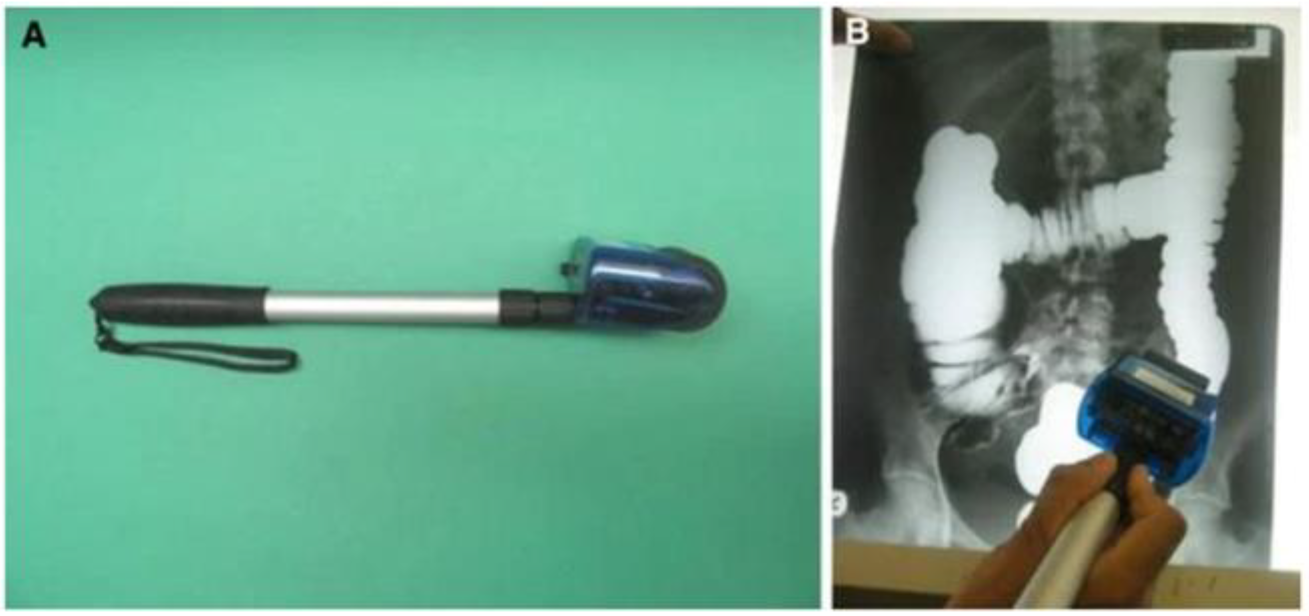 Experimental Measurements of the Length of the Human Colon: A ...