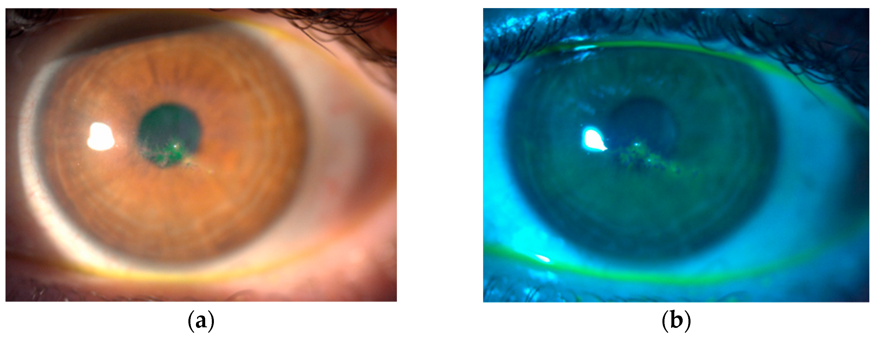 Herpes Simplex Keratitis Following Corneal Crosslinking for Keratoconus ...