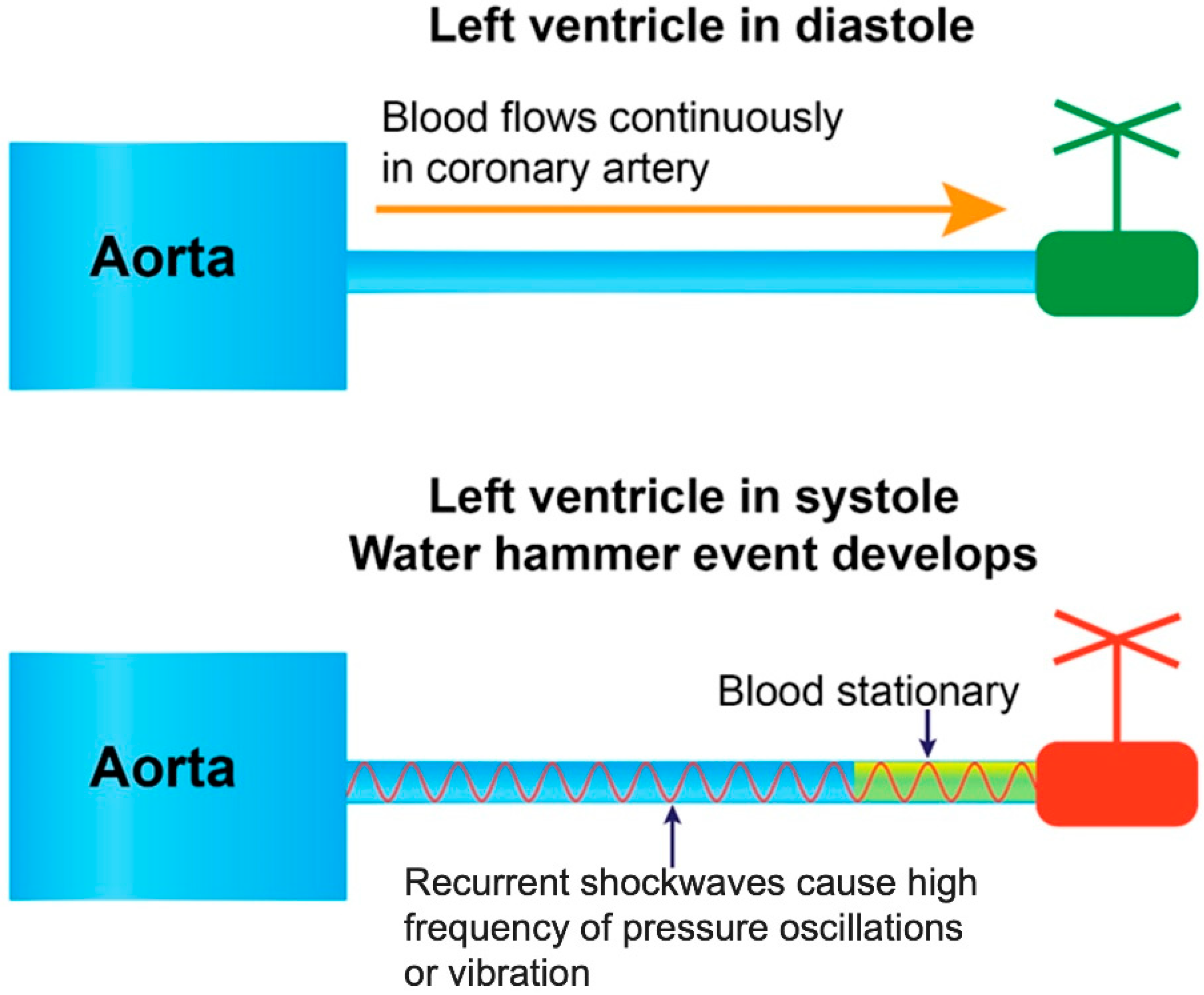 Water Hammer Phenomenon in Coronary Arteries: Scientific Basis for ...