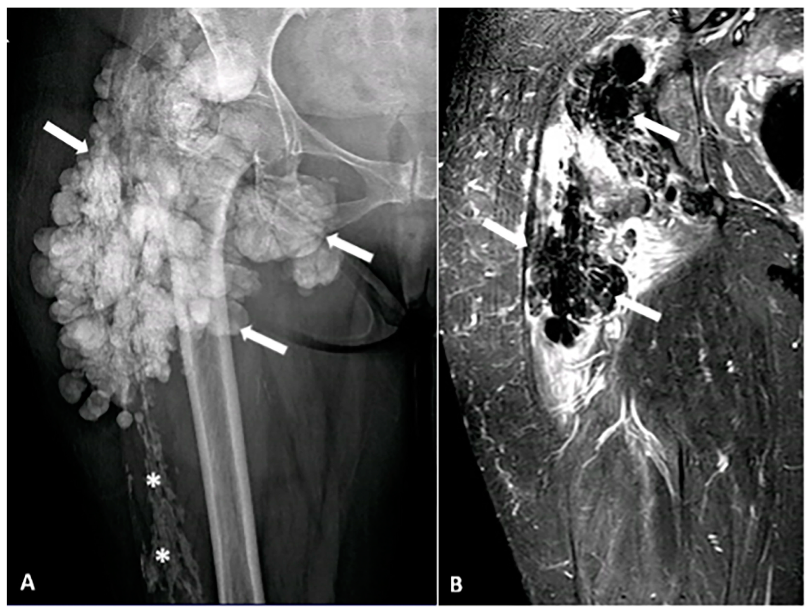 Pictorial Review of Soft Tissue Lesions with Calcification | MDPI