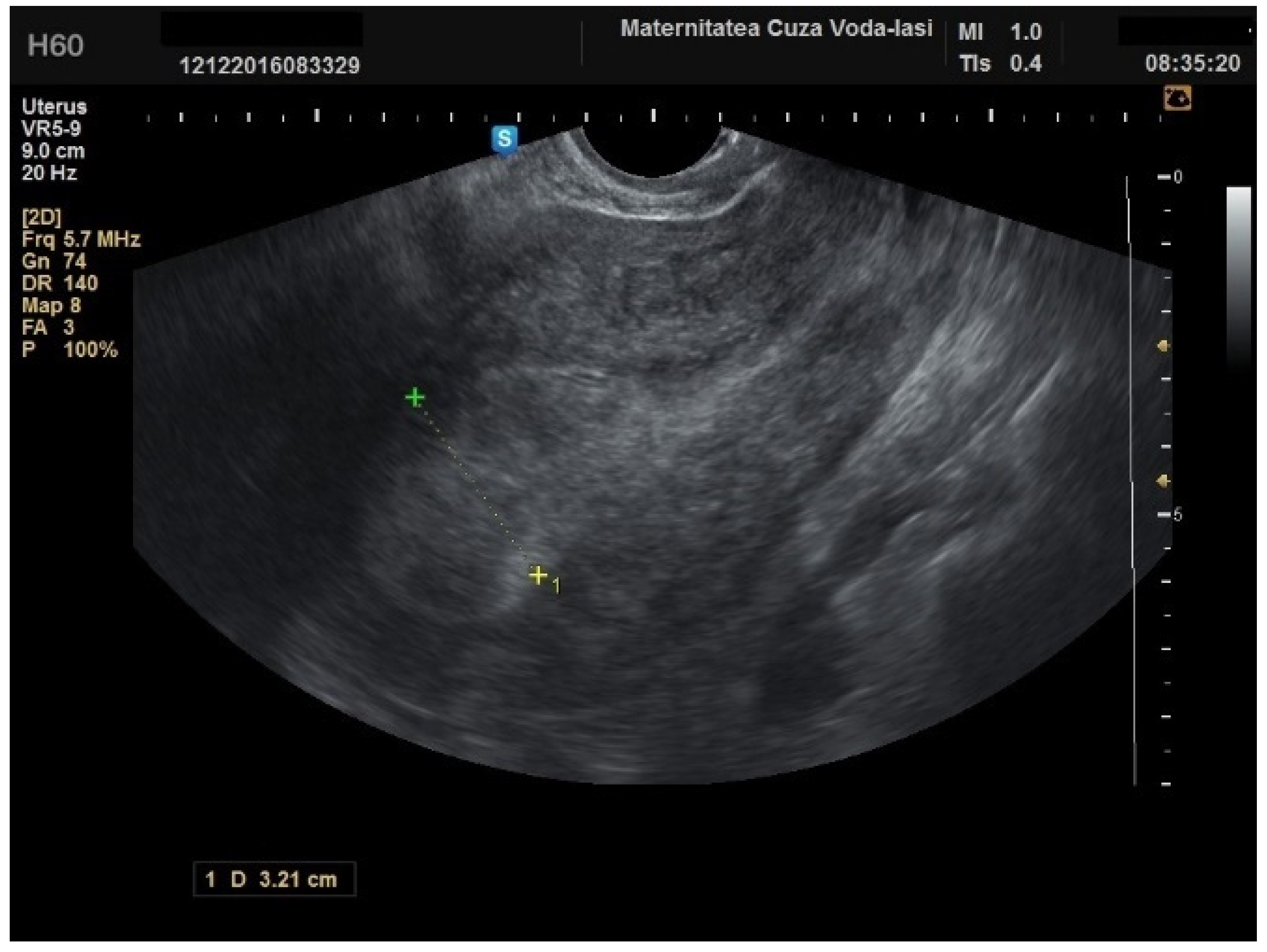 The Role of Ultrasound in Diagnosing Endometrial Pathologies: Adherence ...