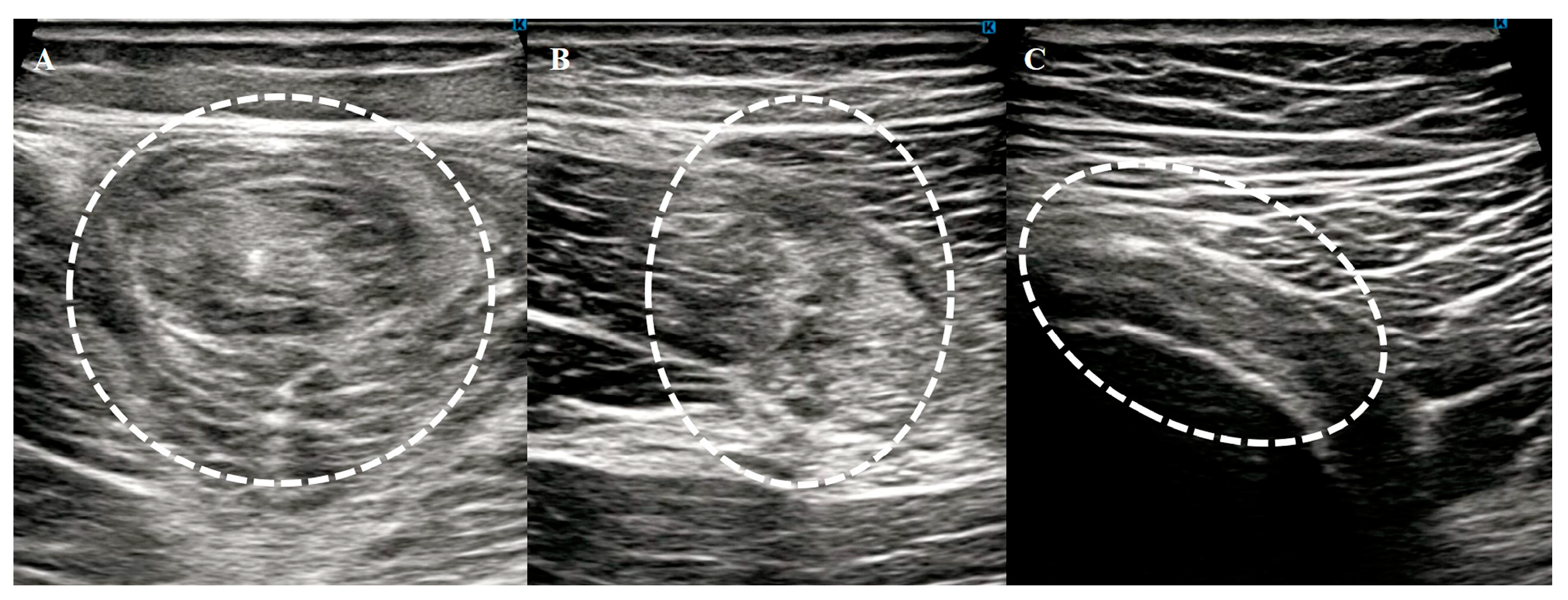 Role of Ultrasonography and MRI in Acute Hamstring Strains: Diagnostic ...